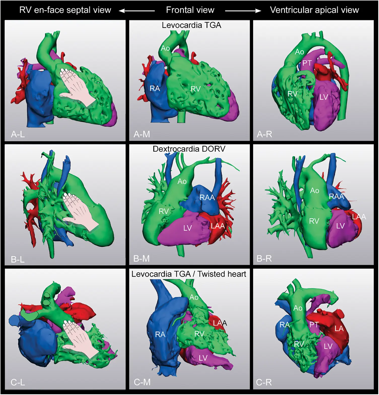 CHD | Free Full-Text | Disharmonious Ventricular Relationship and ...