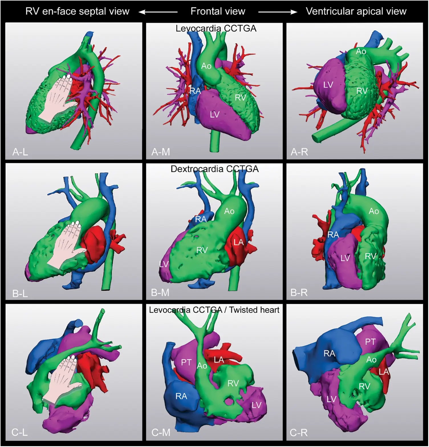 CHD | Free Full-Text | Disharmonious Ventricular Relationship and ...