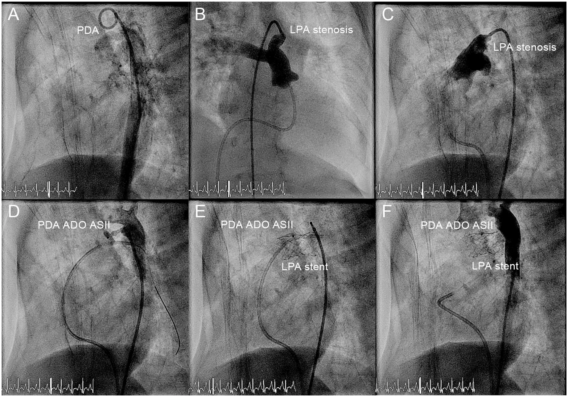 Immediate and Long-Term Results of Transcatheter Closure of Patent ...