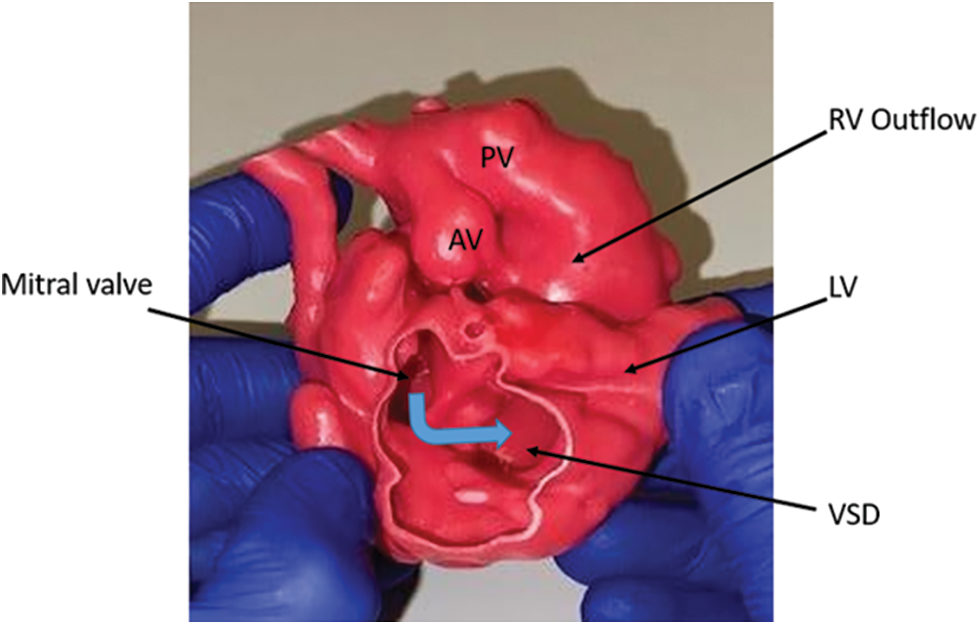 A Rare Case of Concordant Atrioventricular Connection to L-Looped ...