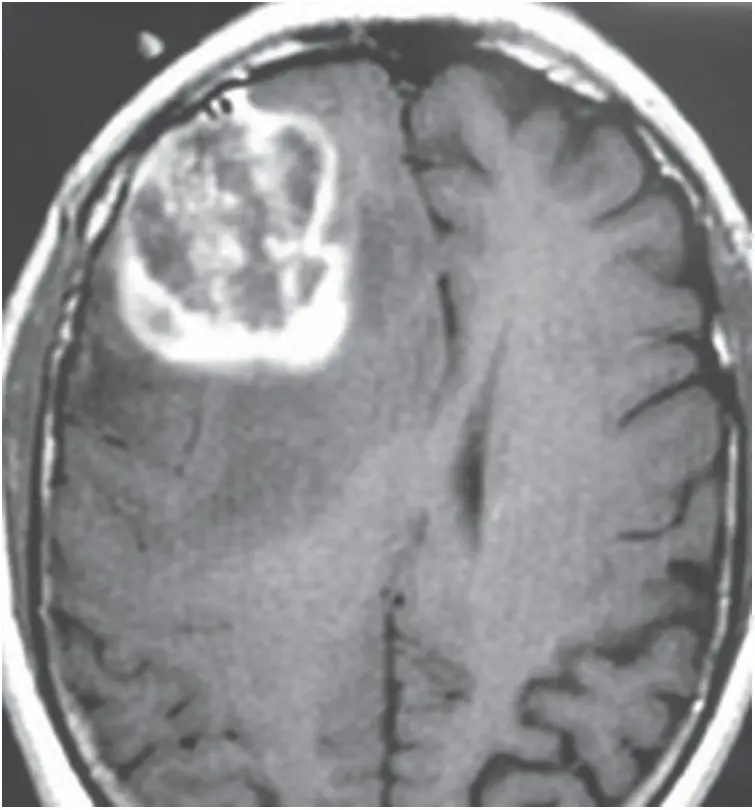 Brain Cancer Tumor Classification from Motion-Corrected MRI Images ...
