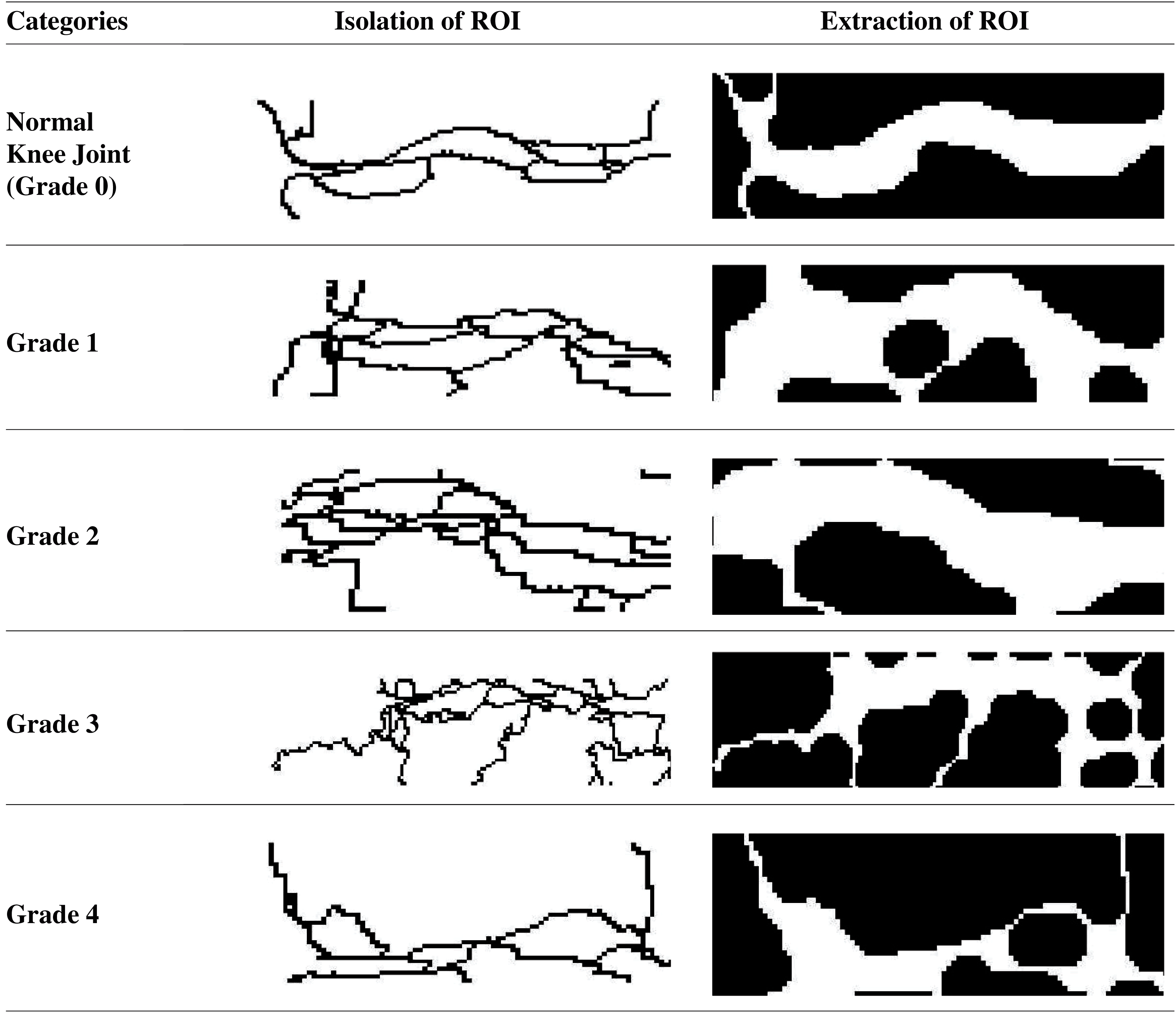 Automatic Detection and Classification of Human Knee Osteoarthritis ...