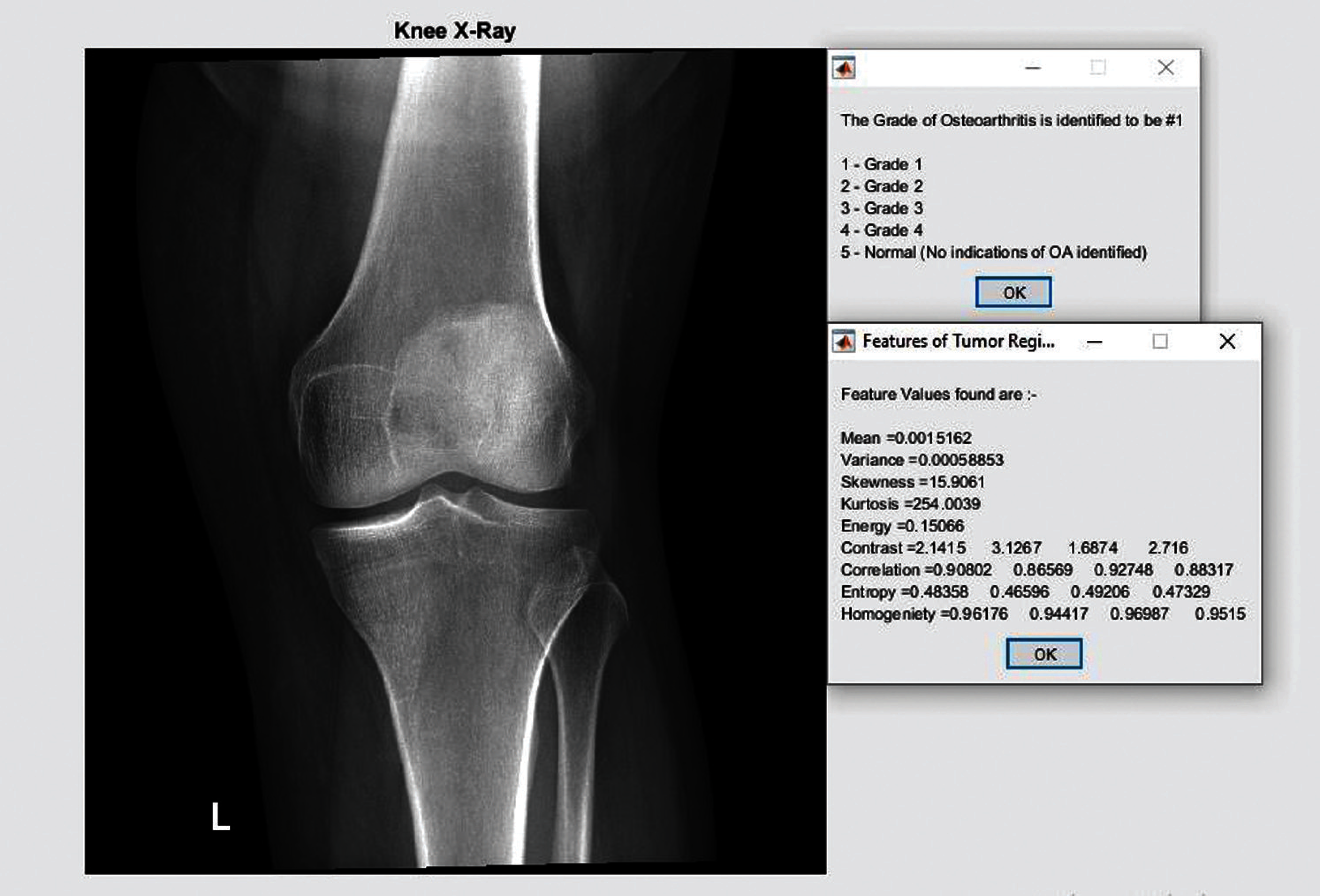 Automatic Detection and Classification of Human Knee Osteoarthritis ...