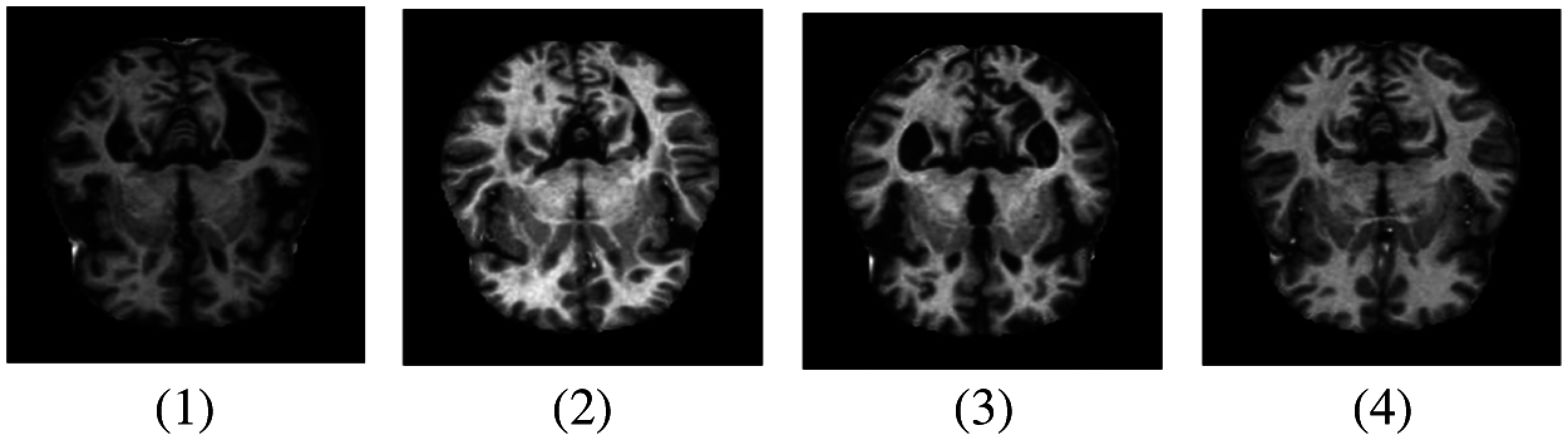 Alzheimer Disease Detection Empowered with Transfer Learning