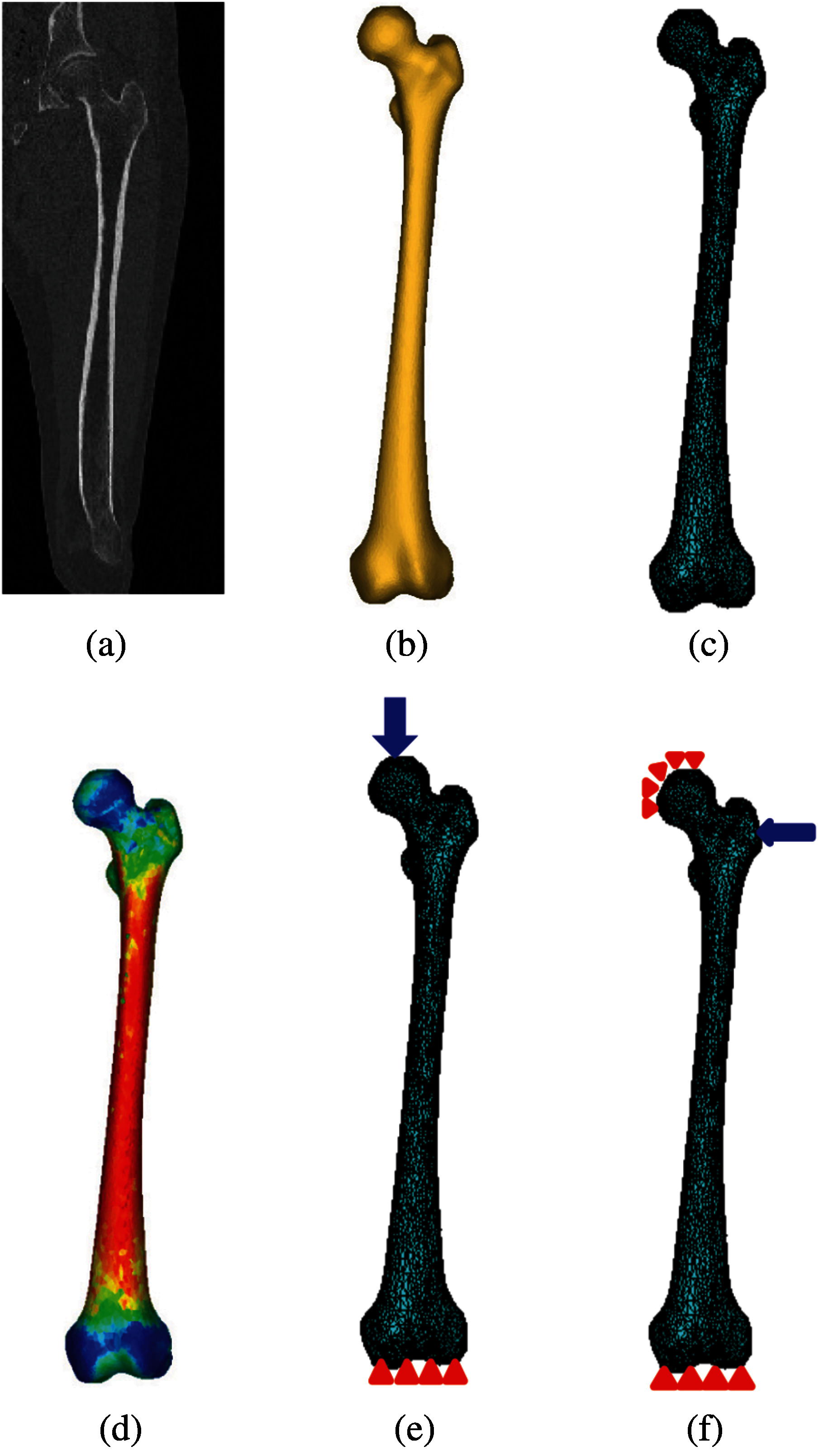 Parametric Study of Hip Fracture Risk Using QCT-Based Finite Element Analysis