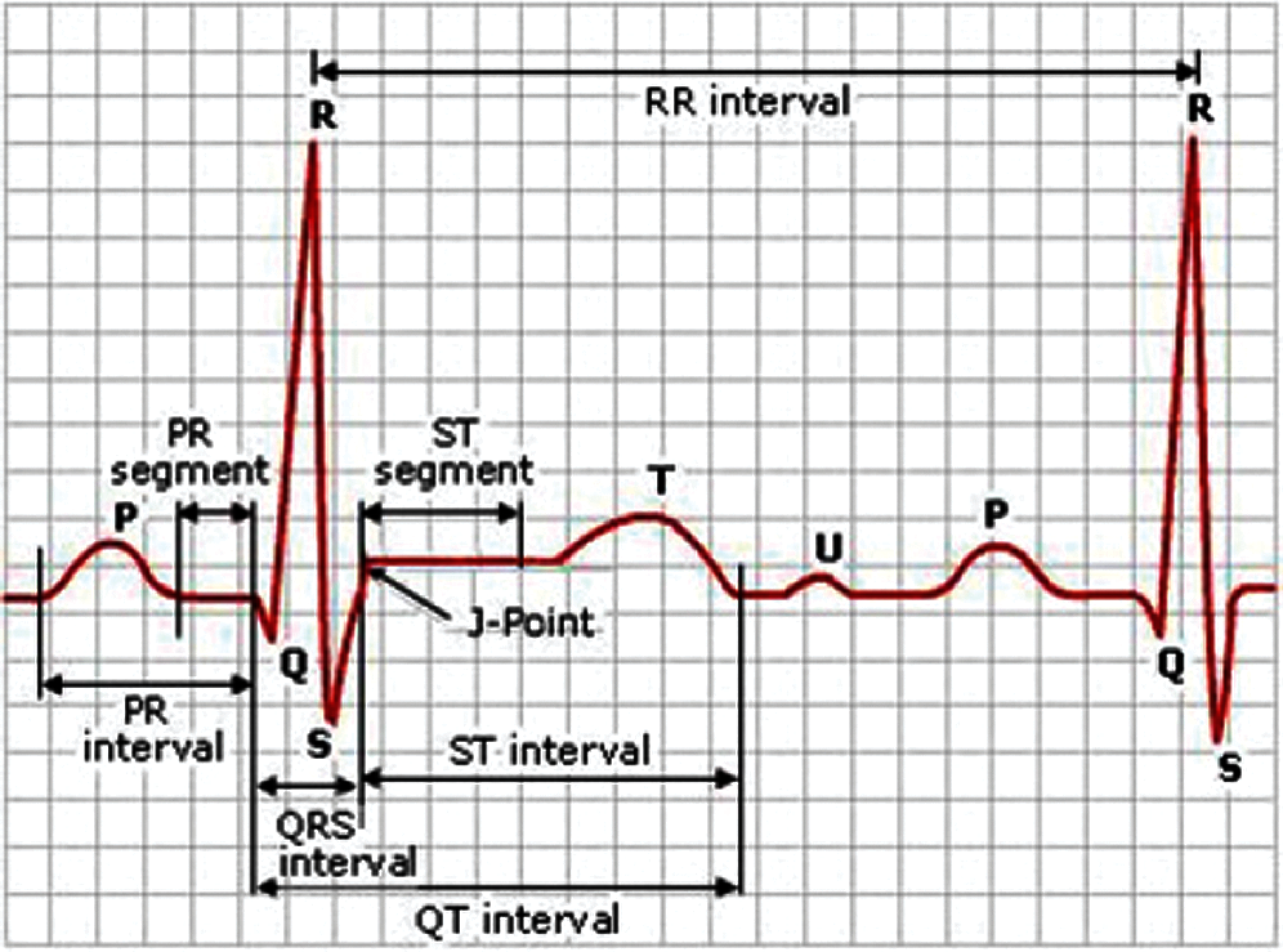 Automatic Heart Disease Detection by Classification of Ventricular ...