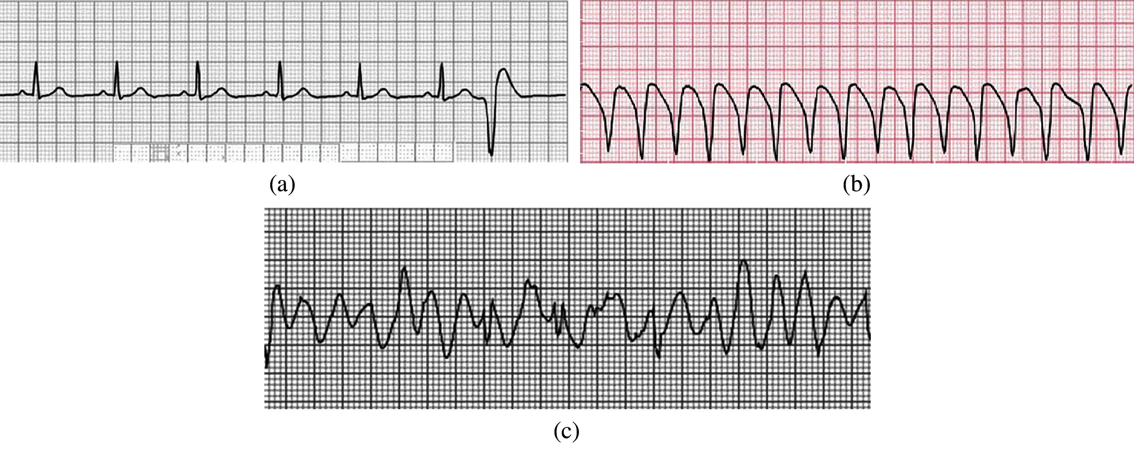 Automatic Heart Disease Detection by Classification of Ventricular ...