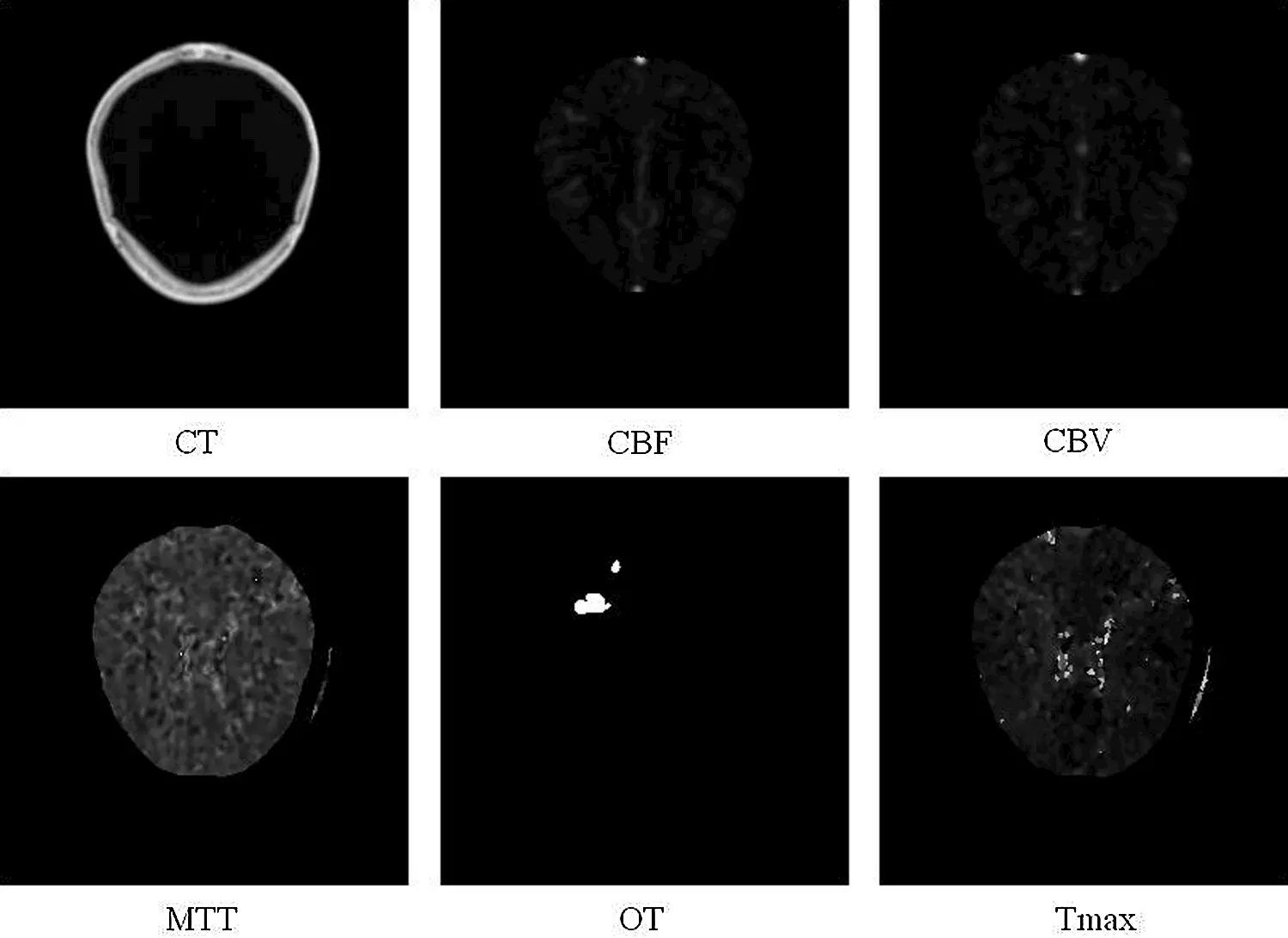 Modified UNet Model for Brain Stroke Lesion Segmentation on Computed Tomography Images
