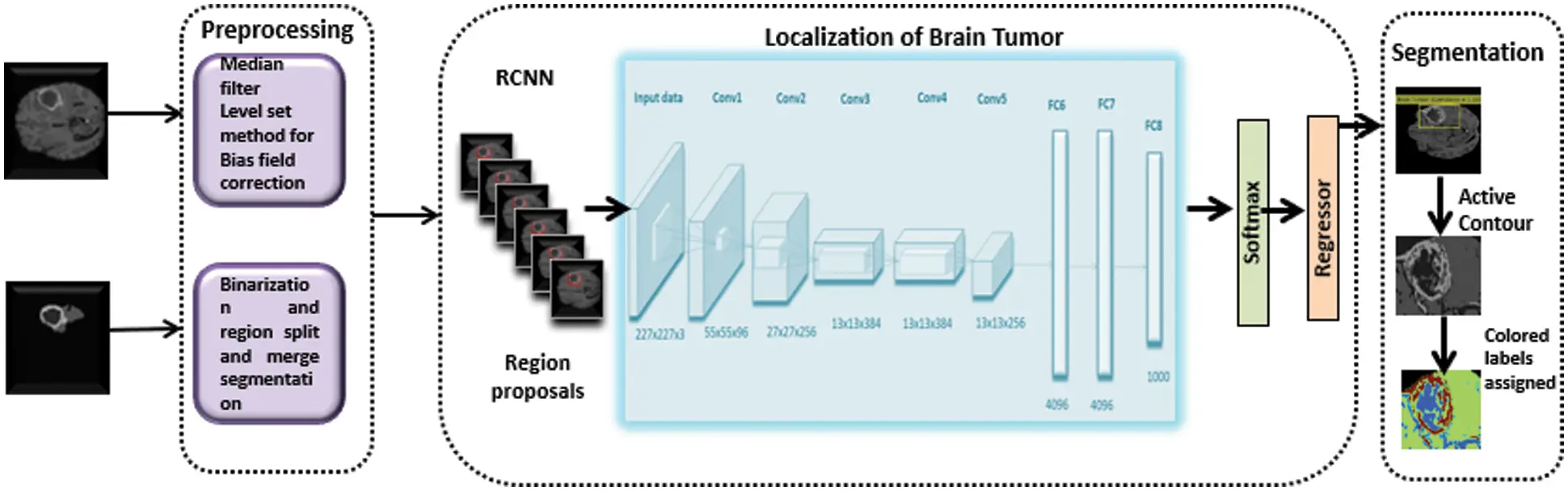 Brain Tumor Detection and Segmentation Using RCNN