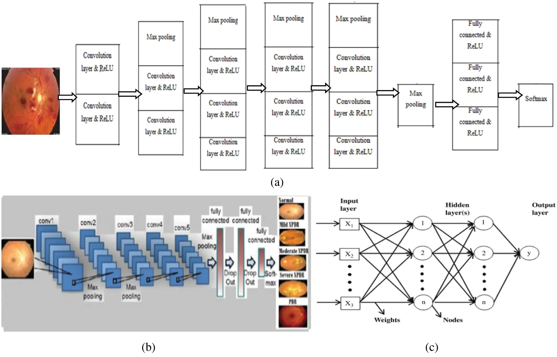 Detection and Classification of Diabetic Retinopathy Using DCNN and BSN ...