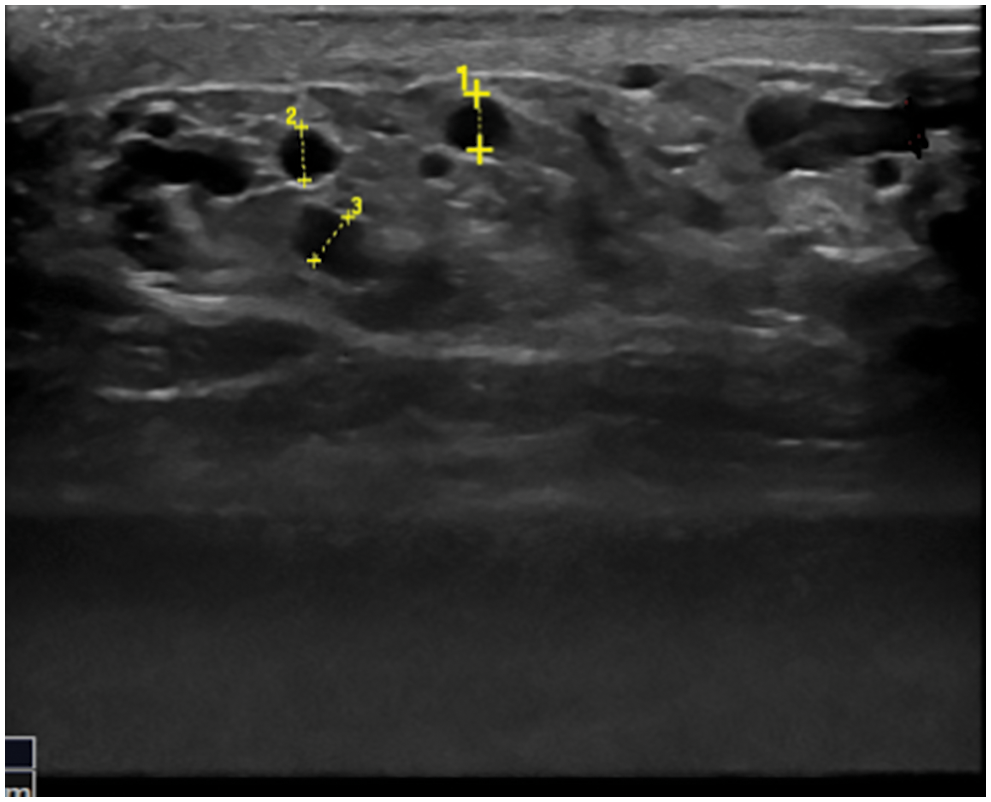 Automatic Segmentation and Detection System for Varicocele Using ...