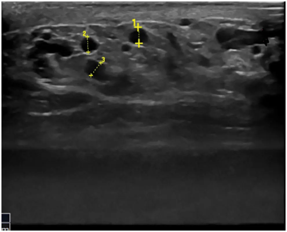 Automatic Segmentation and Detection System for Varicocele Using ...