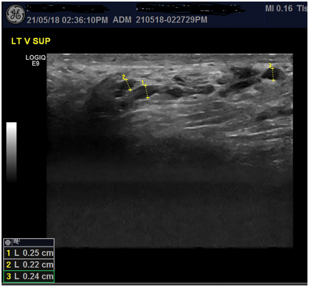 Automatic Segmentation and Detection System for Varicocele Using ...