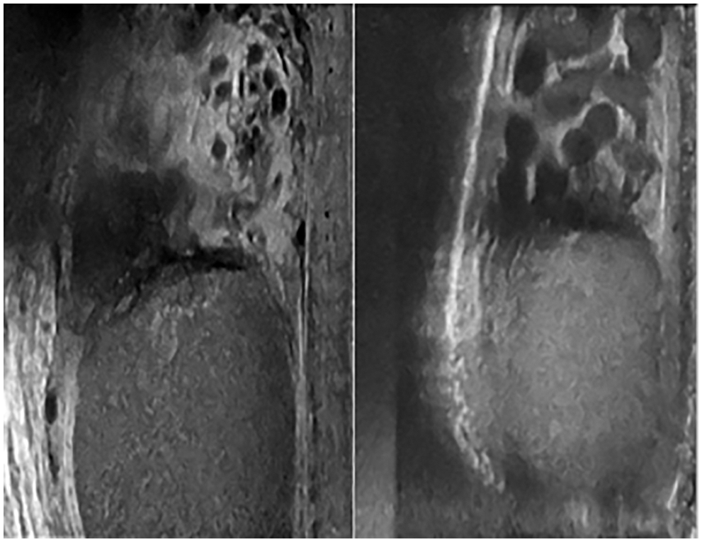 Automatic Segmentation and Detection System for Varicocele Using ...