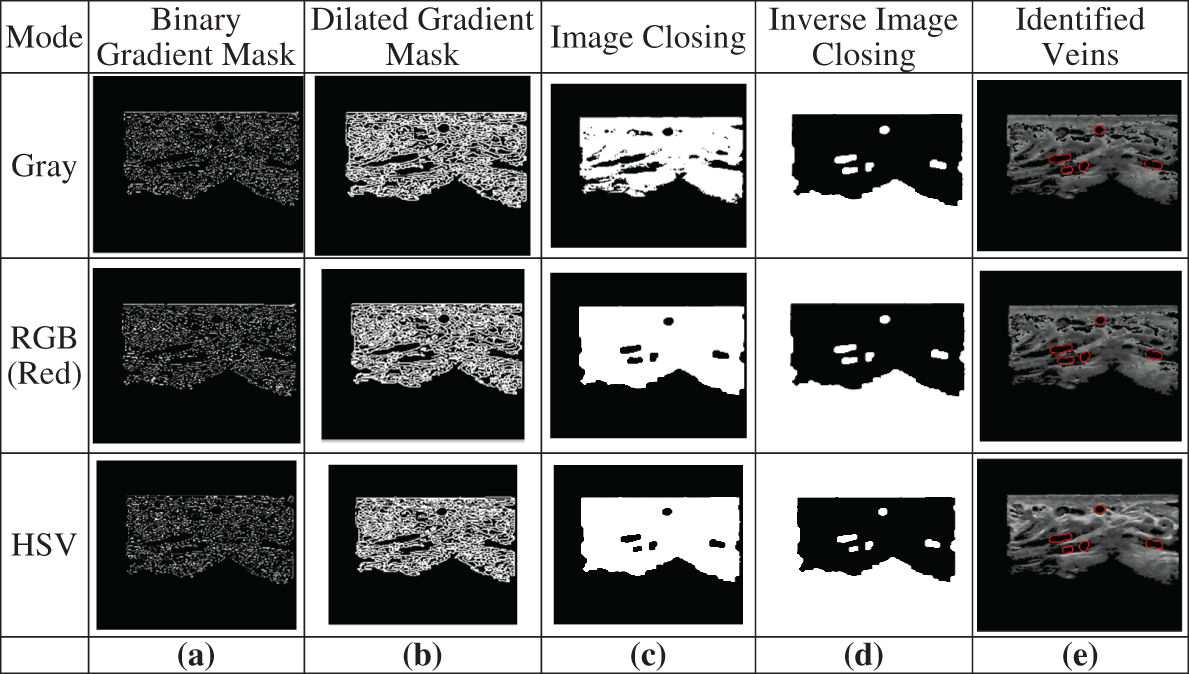 Automatic Segmentation and Detection System for Varicocele Using Ultrasound Images
