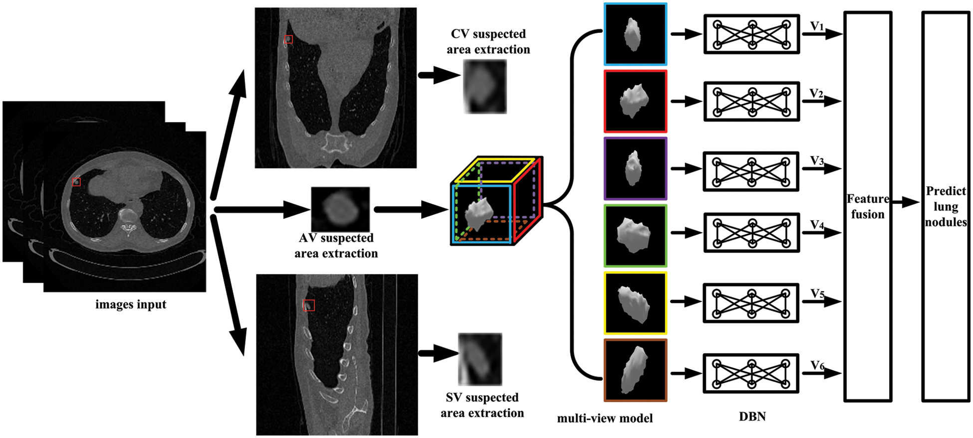 Multi-View Auxiliary Diagnosis Algorithm for Lung Nodules