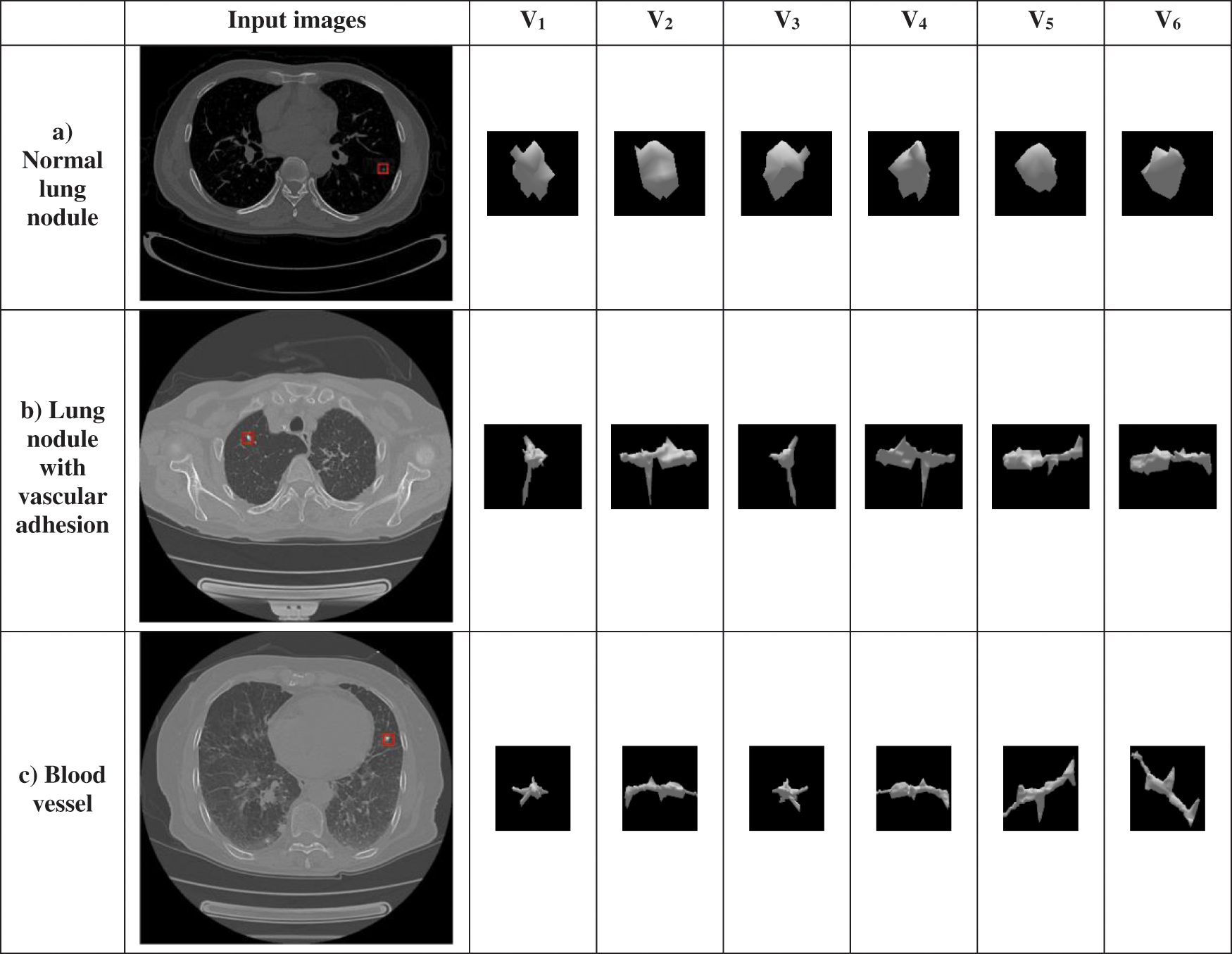 Multi-View Auxiliary Diagnosis Algorithm for Lung Nodules