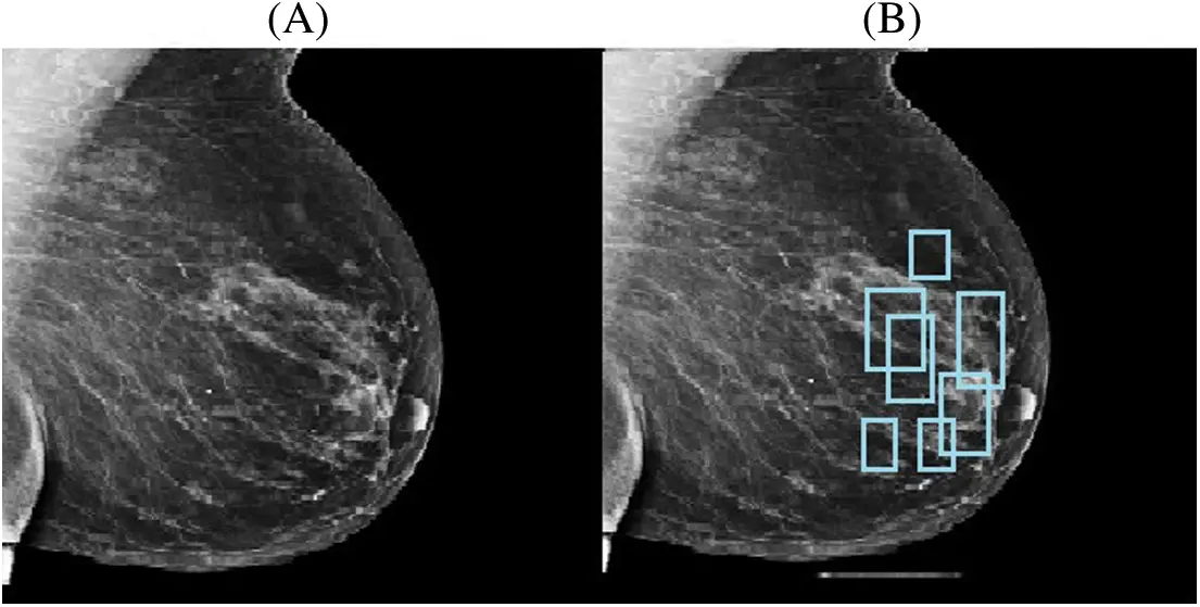 Breast Cancer Detection in Saudi Arabian Women Using Hybrid Machine ...