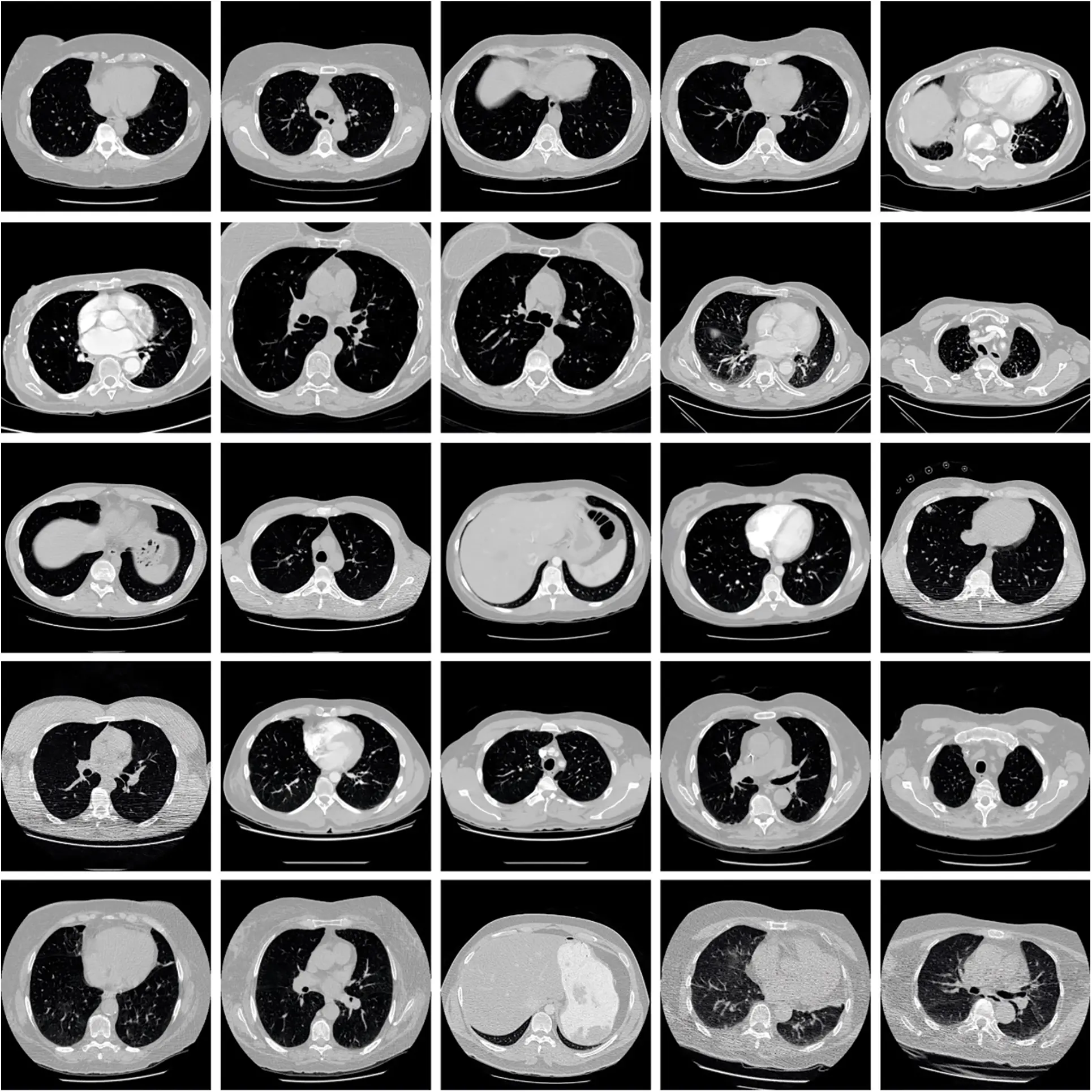 Deer Hunting Optimization with Deep Learning Model for Lung Cancer ...