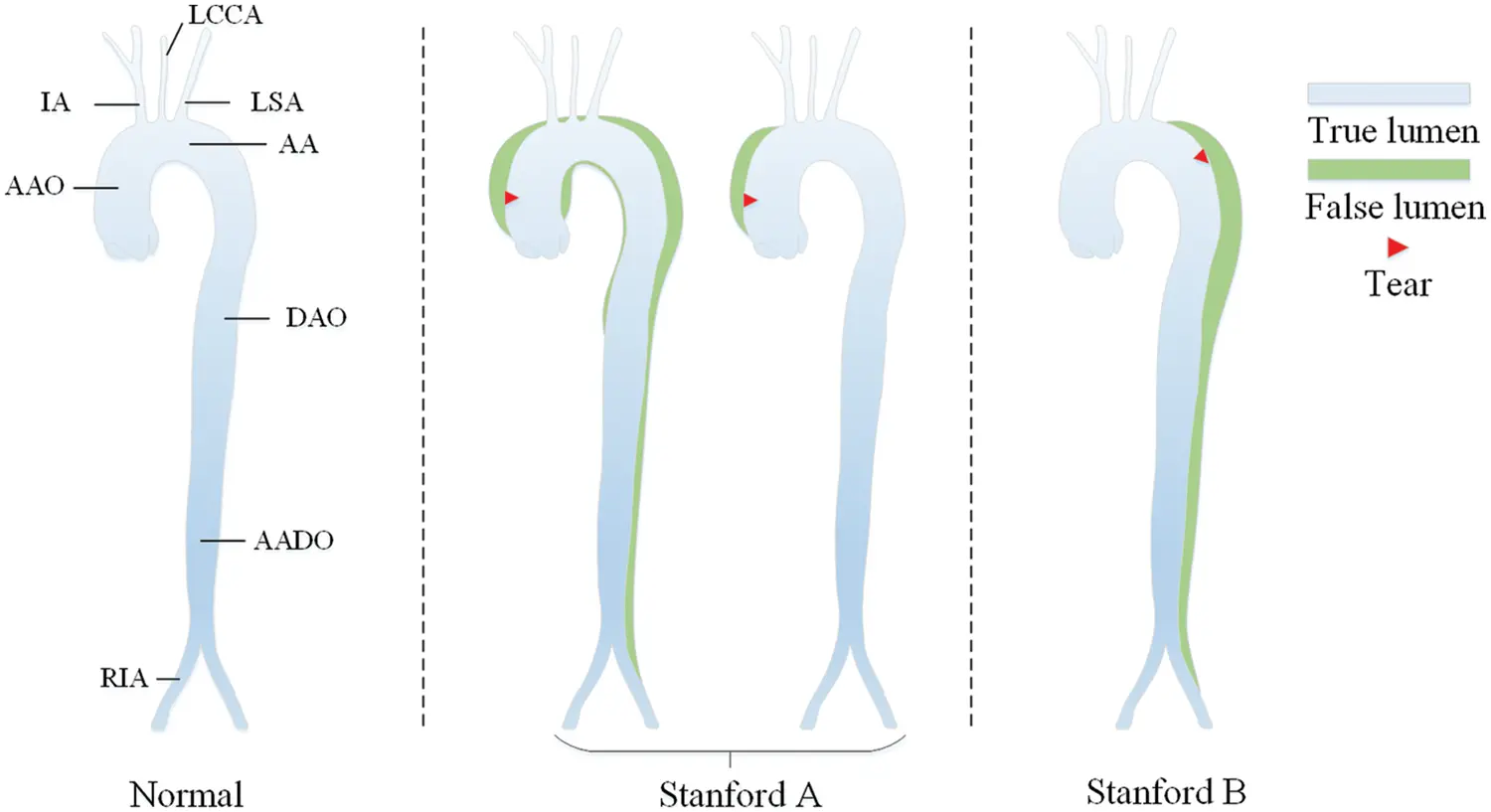 Aortic Dissection Diagnosis Based on Sequence Information and Deep Learning