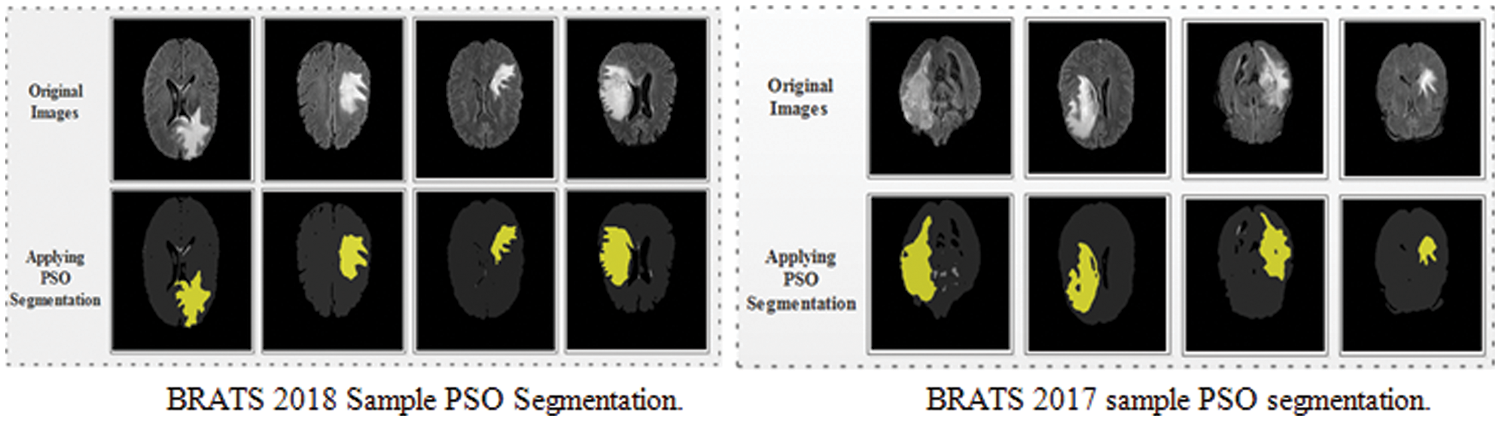 Brain Tumor Detection and Classification Using PSO and Convolutional ...