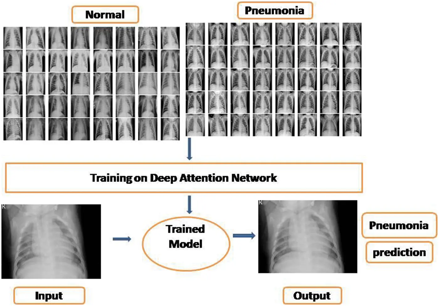CMC | Free Full-Text | Deep Attention Network for Pneumonia Detection ...