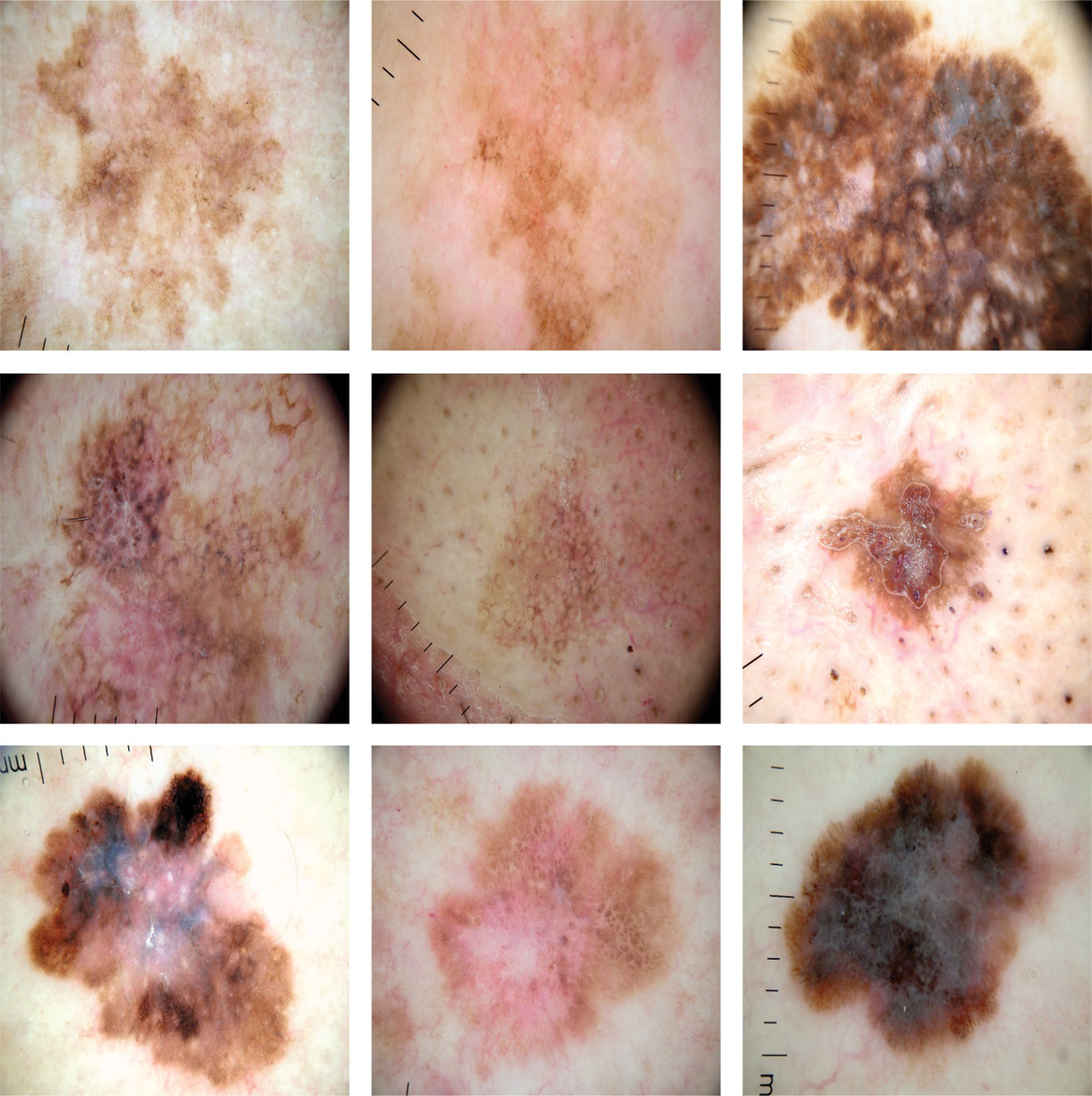 CMC | Free Full-Text | Automated Deep Learning Based Melanoma Detection ...