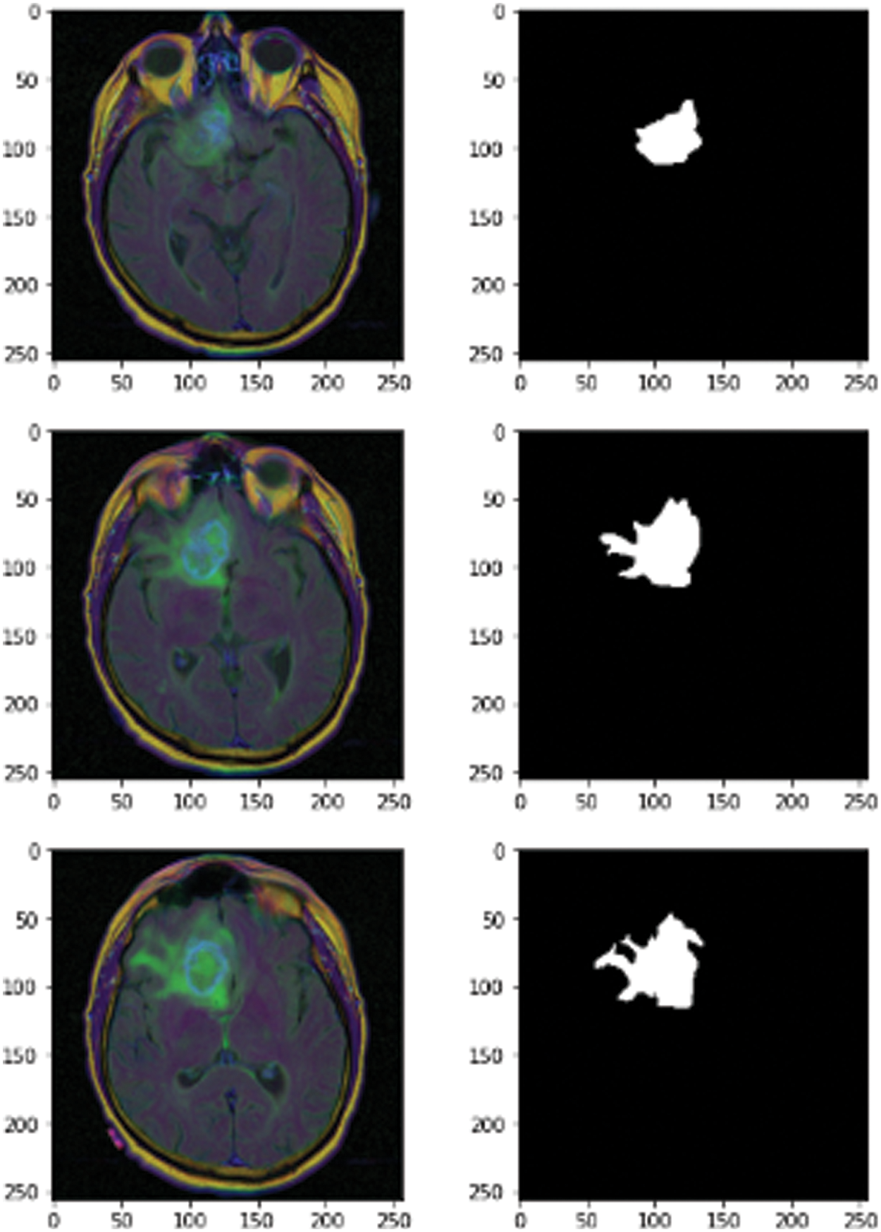 CMC | Free Full-Text | Novel Framework of Segmentation 3D MRI of Brain Tumors