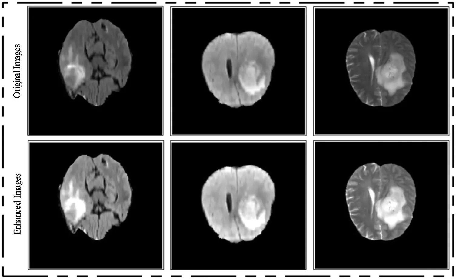 Deep Learning and Improved Particle Swarm Optimization Based Multimodal Brain Tumor Classification