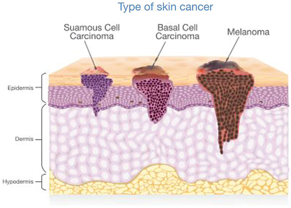 Intelligent Multiclass Skin Cancer Detection Using Convolution Neural ...