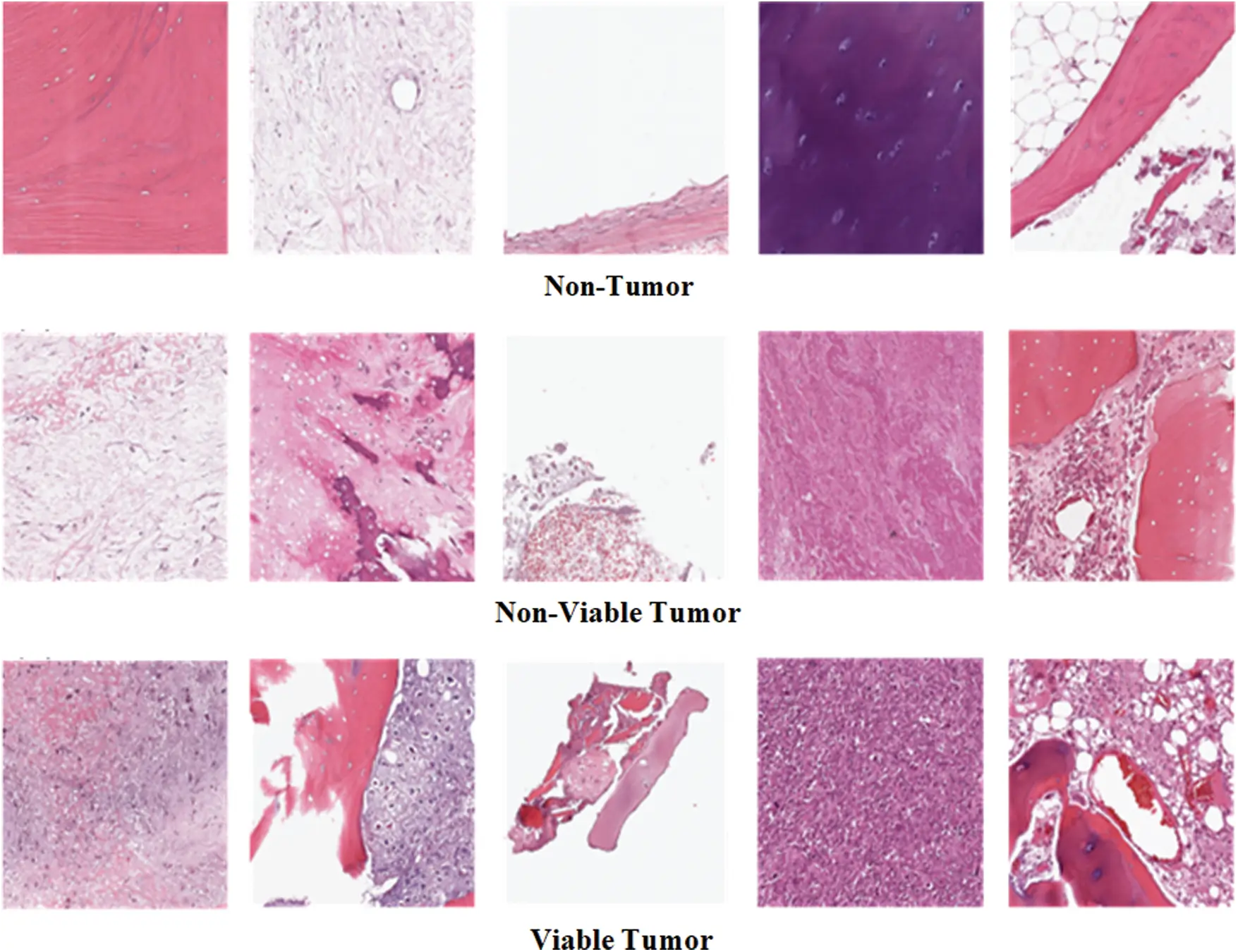 Convolutional Neural Network for Histopathological Osteosarcoma Image Classification