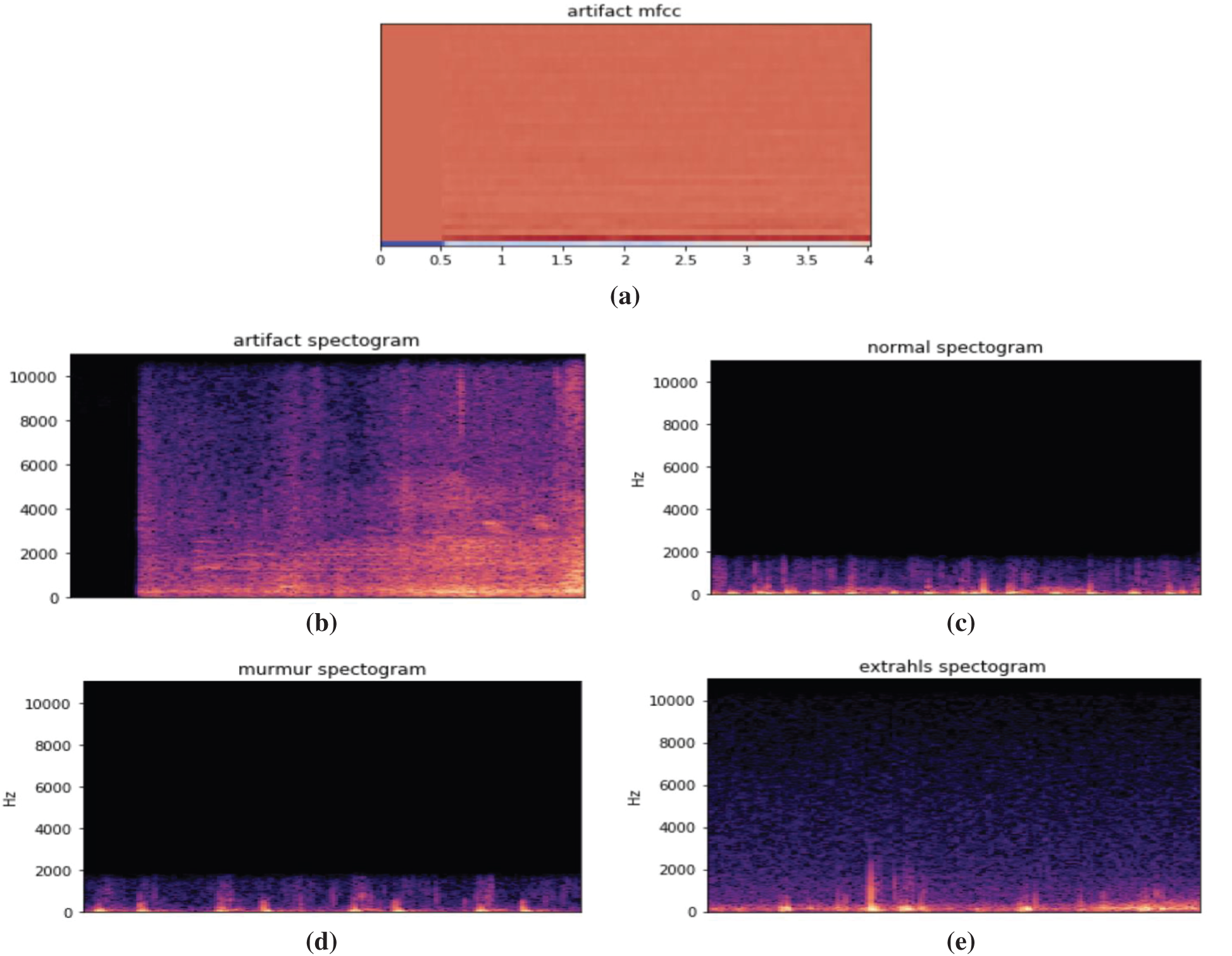 Artificial Intelligence in Medicine: Real Time Electronic Stethoscope ...