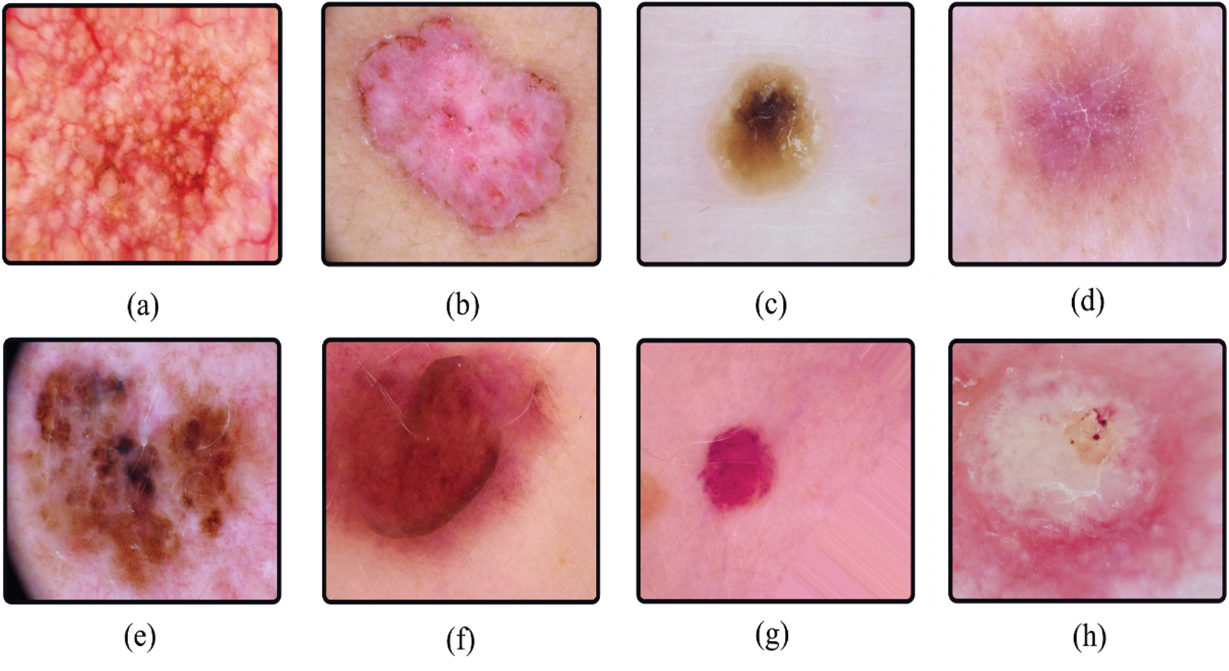 Optimized Convolutional Neural Network Models for Skin Lesion ...