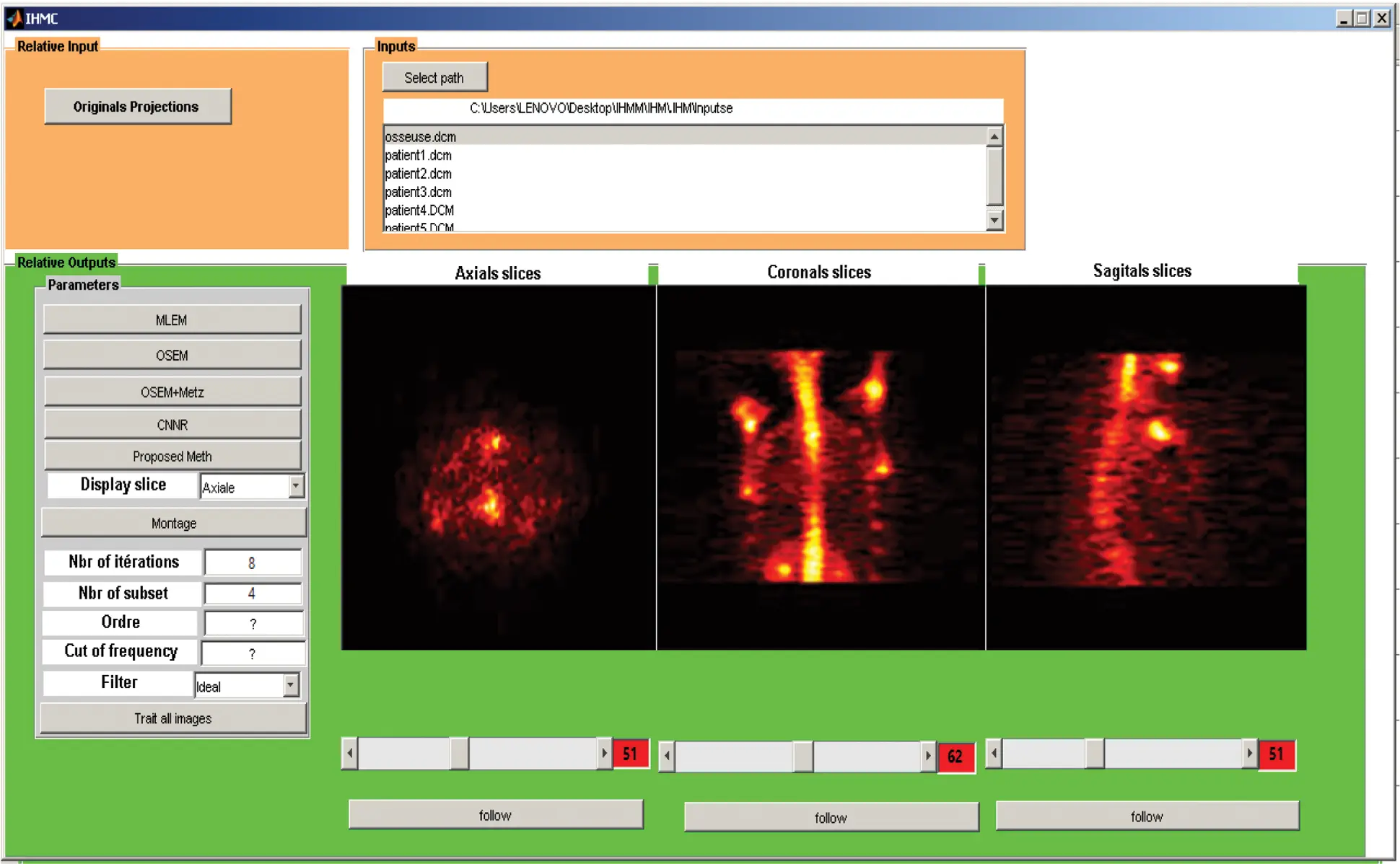 Fast and Accurate Thoracic SPECT Image Reconstruction