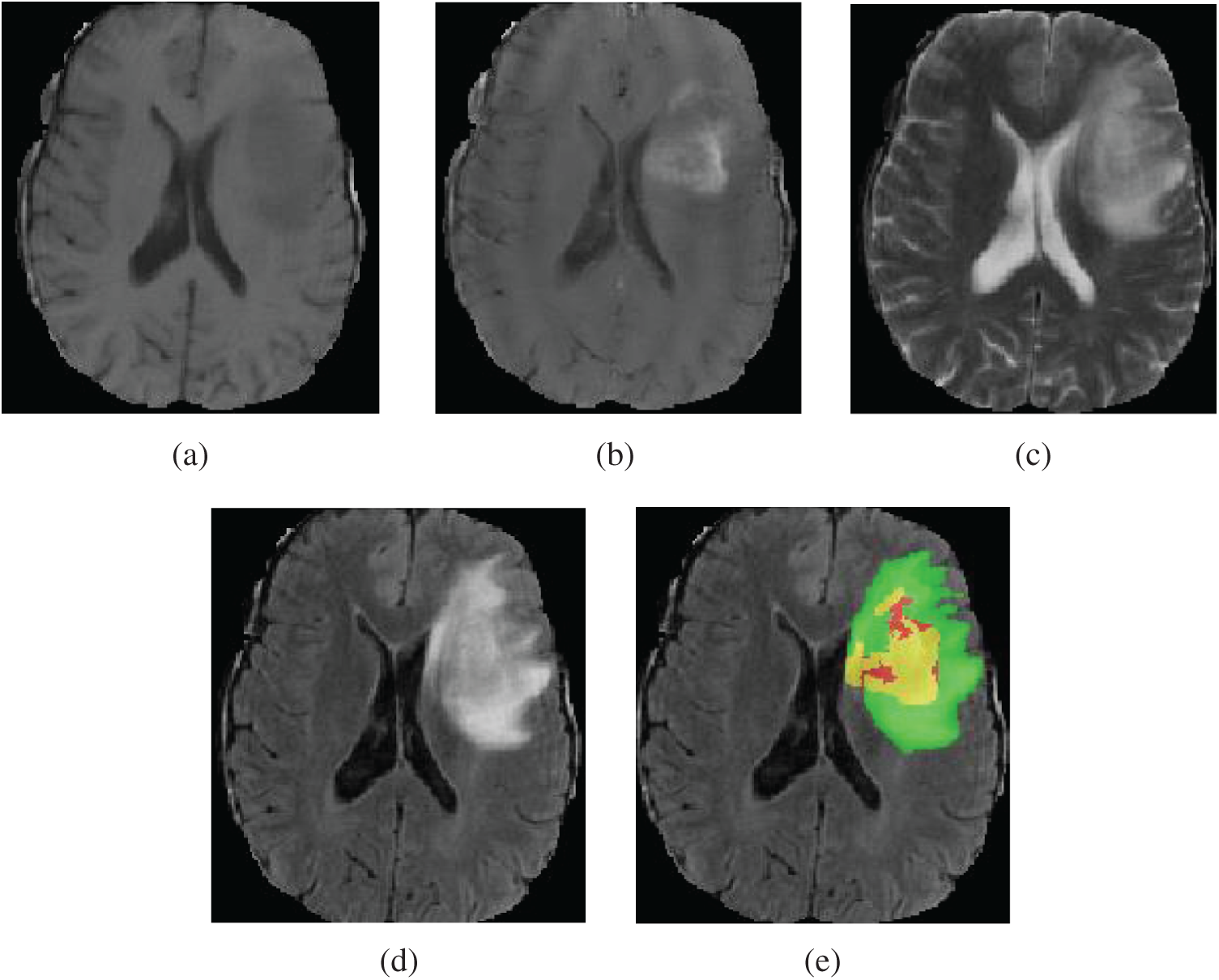 MRI Brain Tumor Segmentation Using 3D U-Net with Dense Encoder Blocks and Residual Decoder Blocks