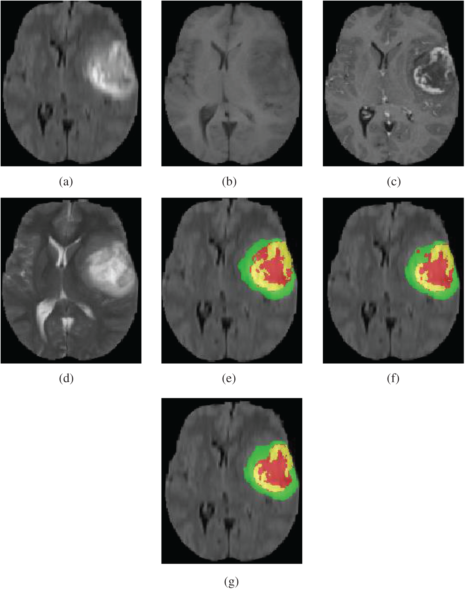 MRI Brain Tumor Segmentation Using 3D U-Net with Dense Encoder Blocks and Residual Decoder Blocks