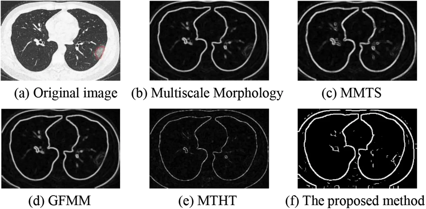 Edge Detection of COVID-19 CT Image Based on GF_SSR, Improved Multiscale Morphology, and ...