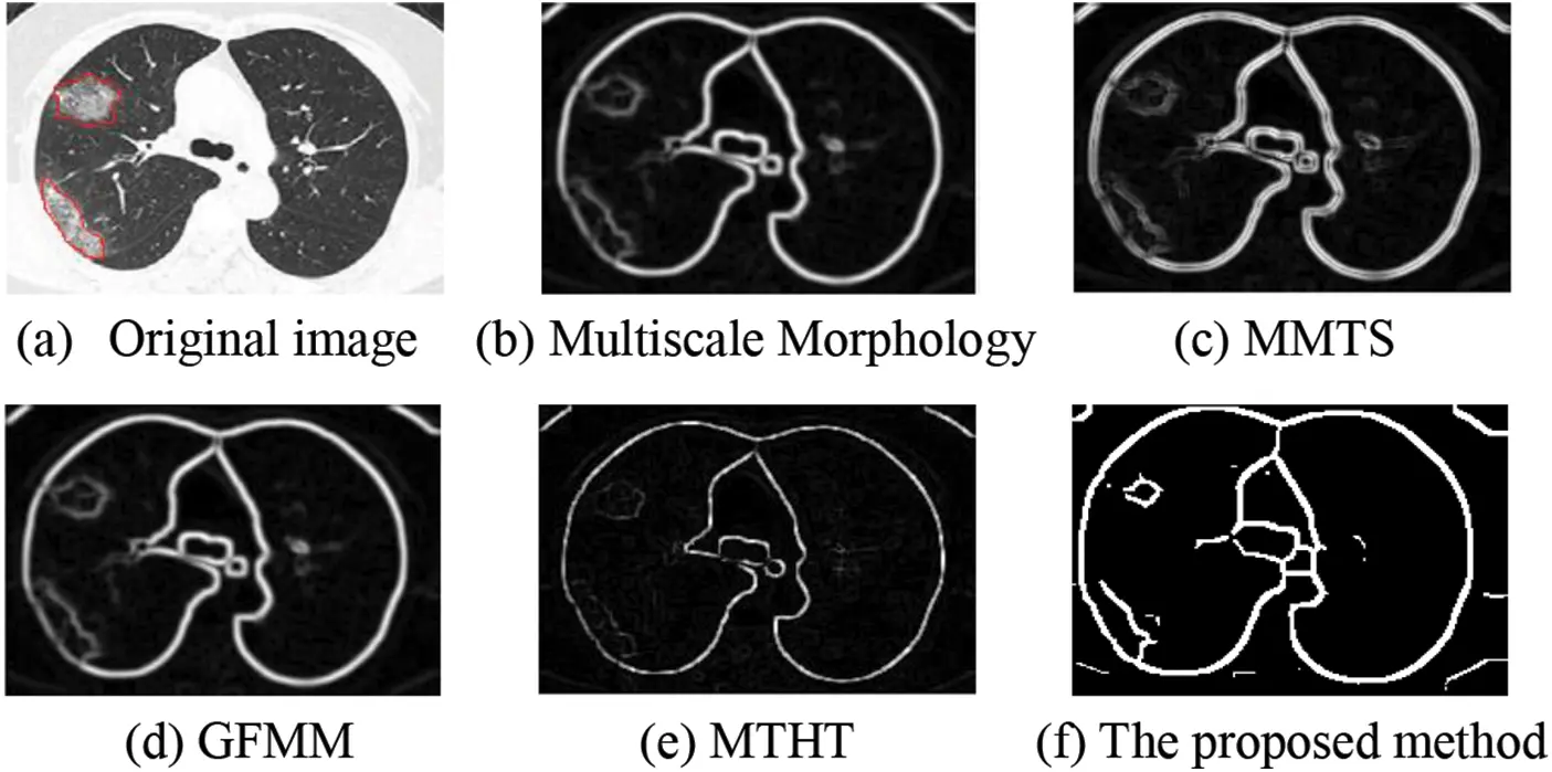 Edge Detection of COVID-19 CT Image Based on GF_SSR, Improved ...