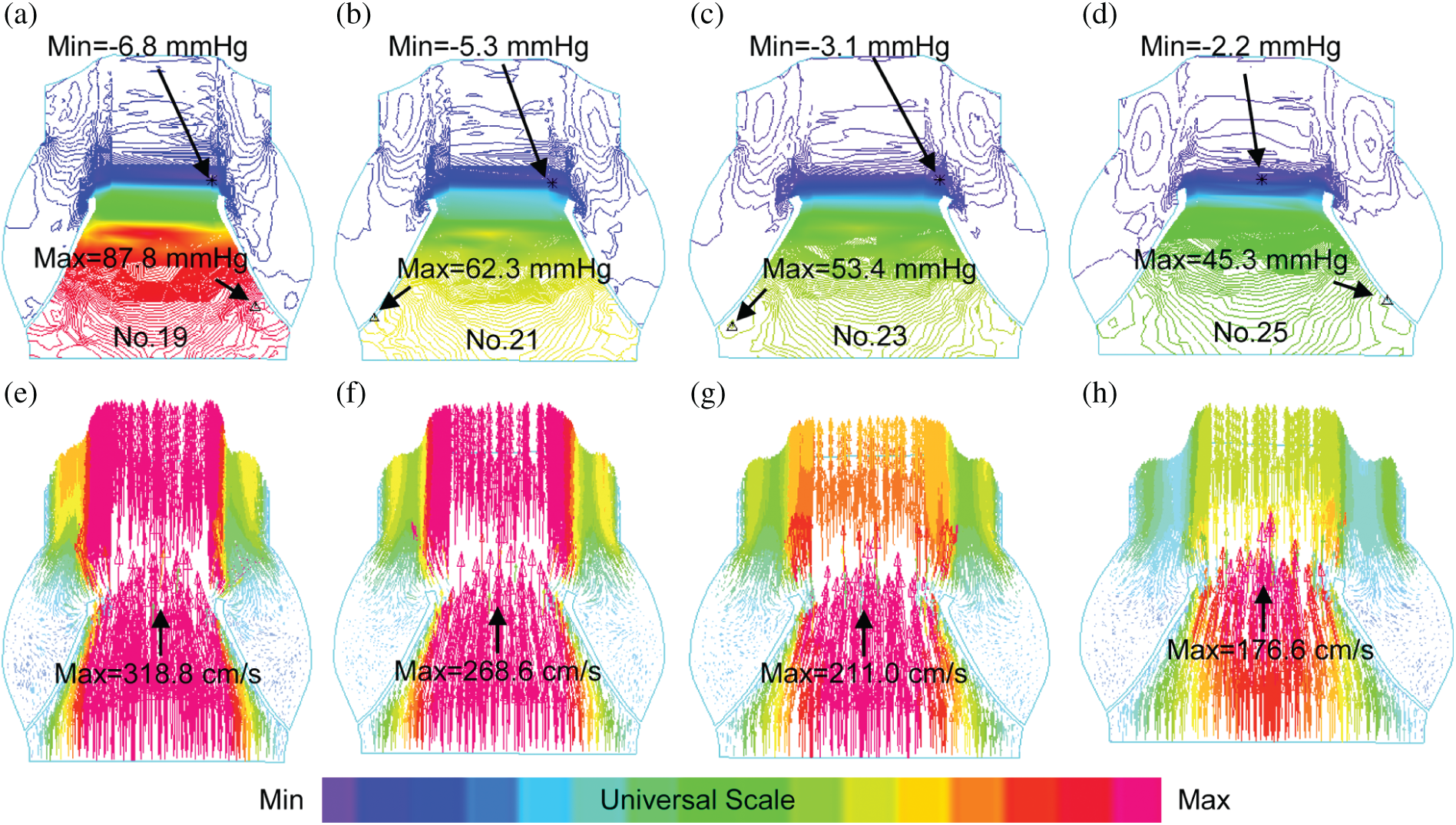 Bioprosthetic Valve Size Selection to Optimize Aortic Valve Replacement ...