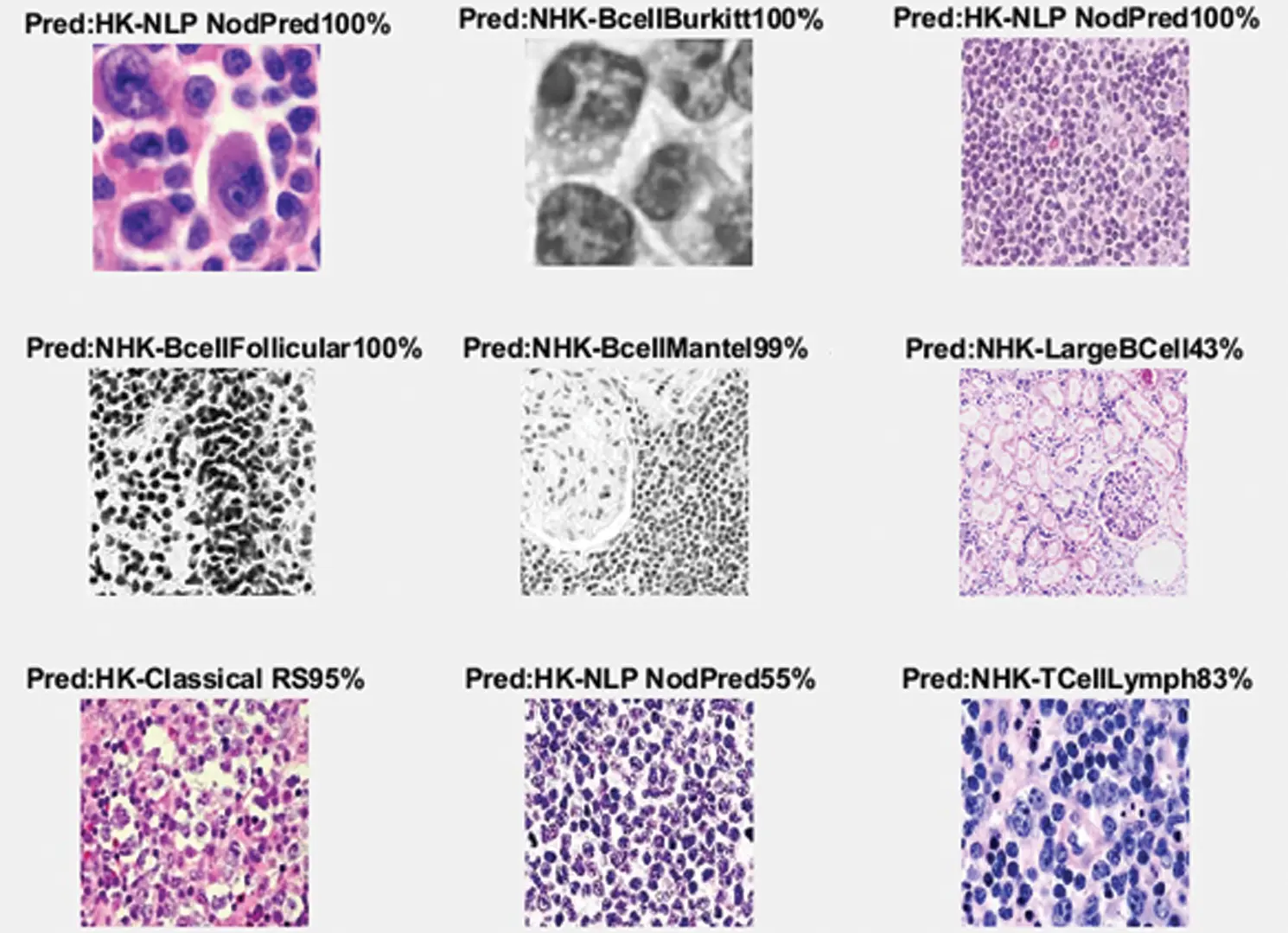 Classification and Diagnosis of Lymphoma’s Histopathological Images ...