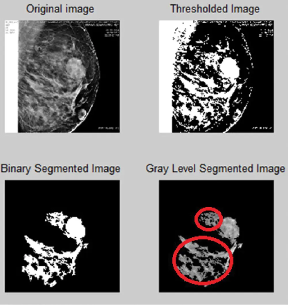 Hybrid Active Contour Mammographic Mass Segmentation and Classification