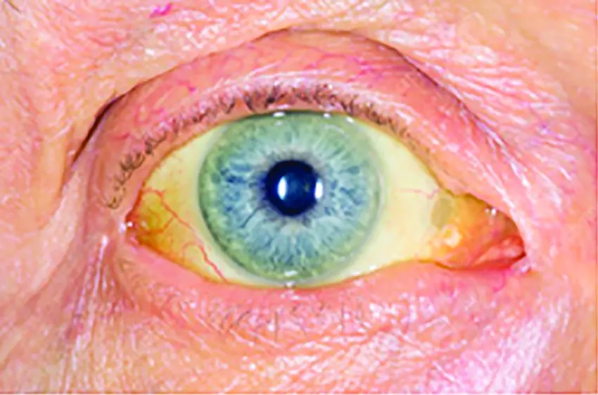 Early Detection of Pancreatic Cancer Using Jaundiced Eye Images