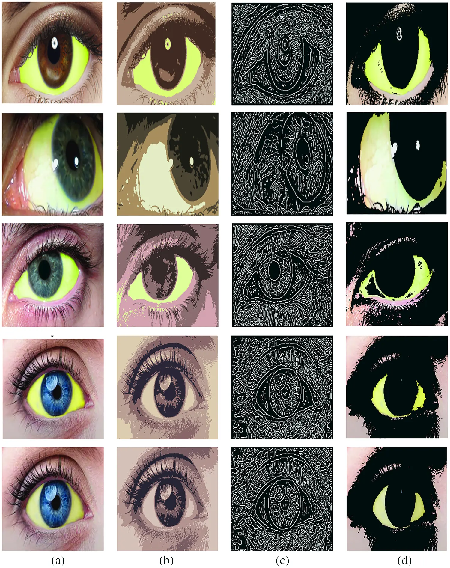 Early Detection of Pancreatic Cancer Using Jaundiced Eye Images