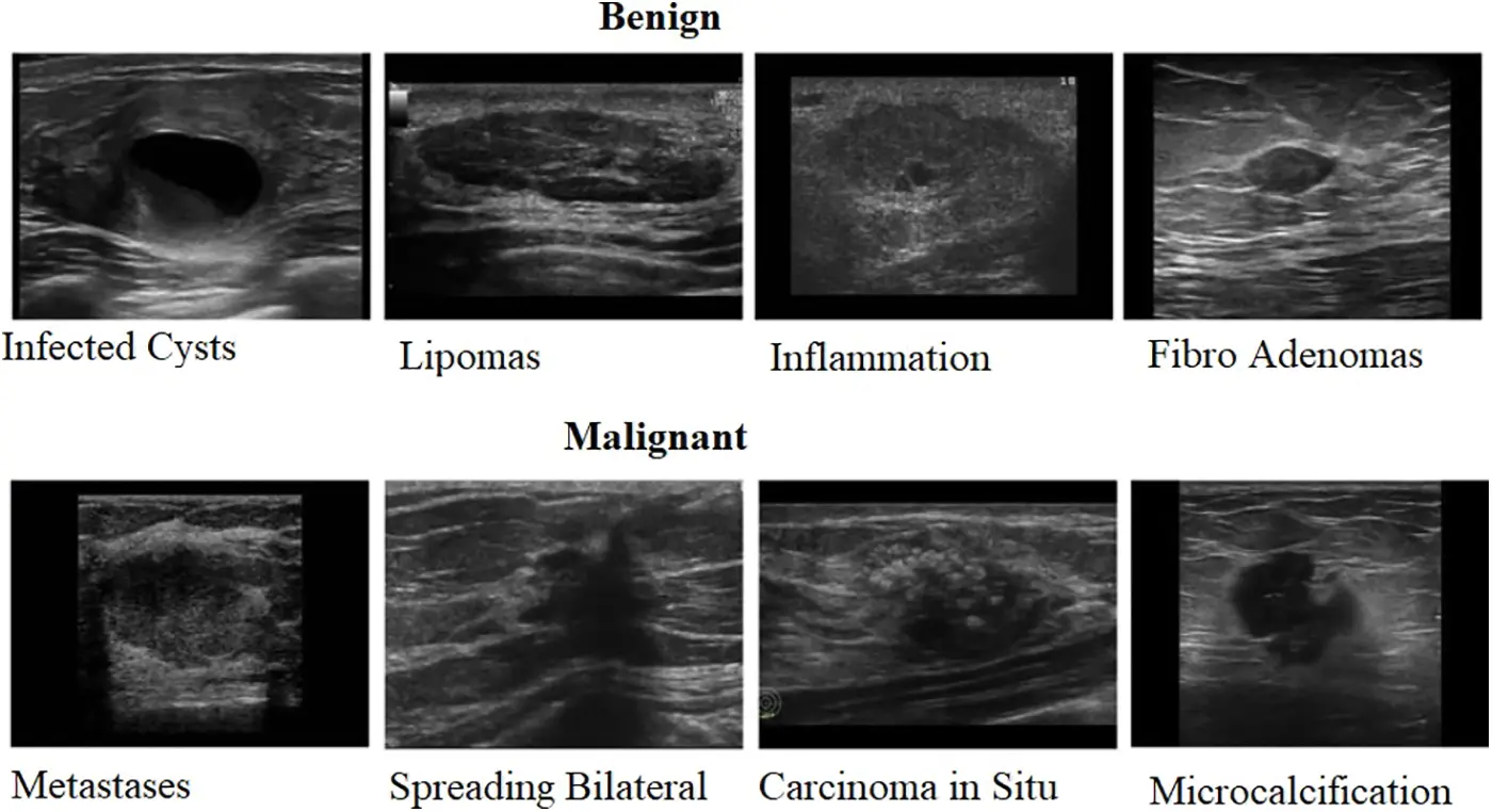 Breast Mammogram Analysis and Classification Using Deep Convolution ...
