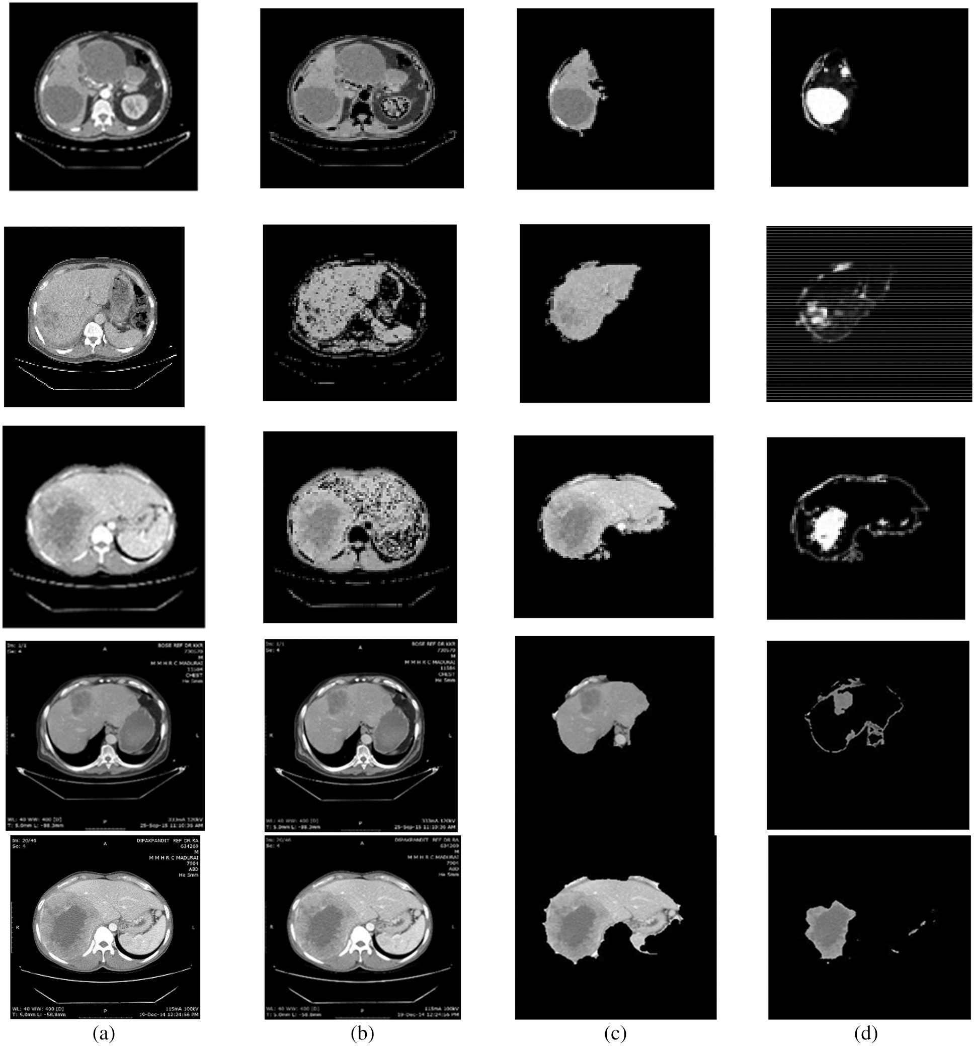 Automatic Liver Tumor Segmentation in CT Modalities Using MAT-ACM