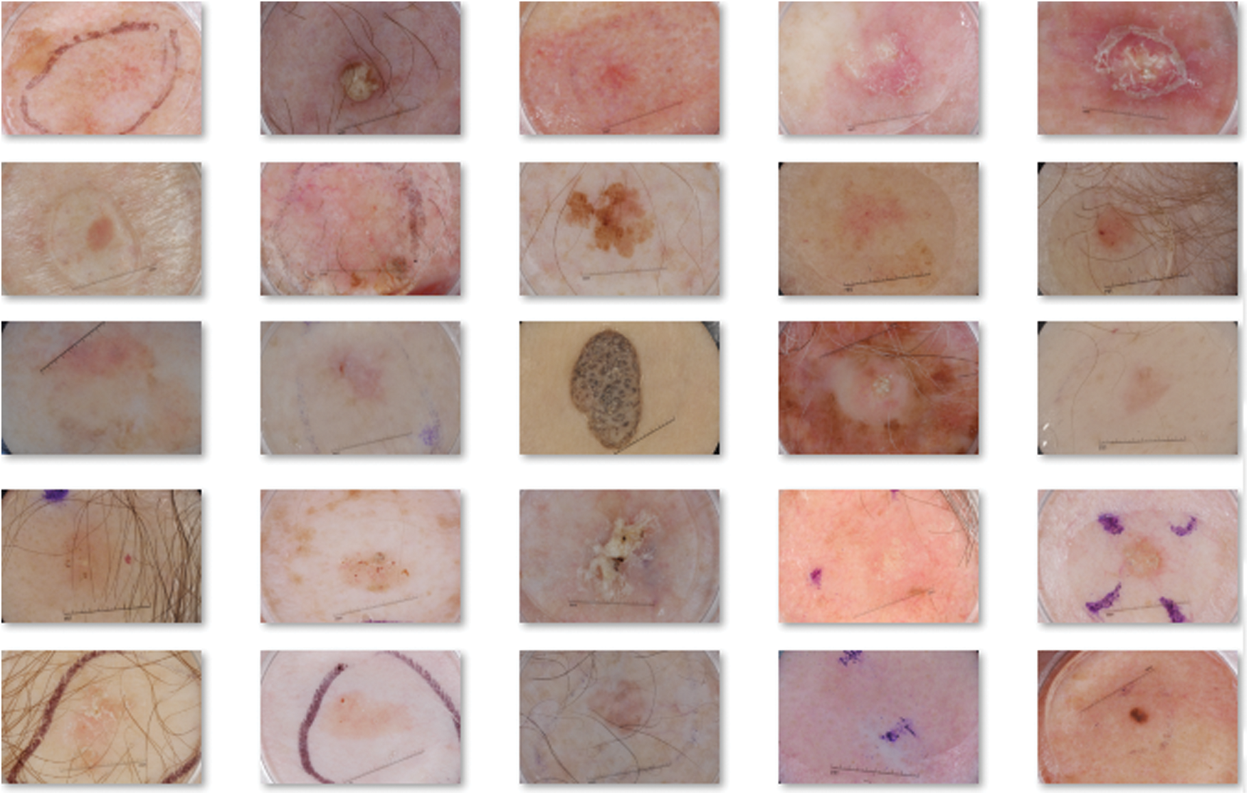 Optimal Artificial Intelligence Based Automated Skin Lesion Detection and Classification Model