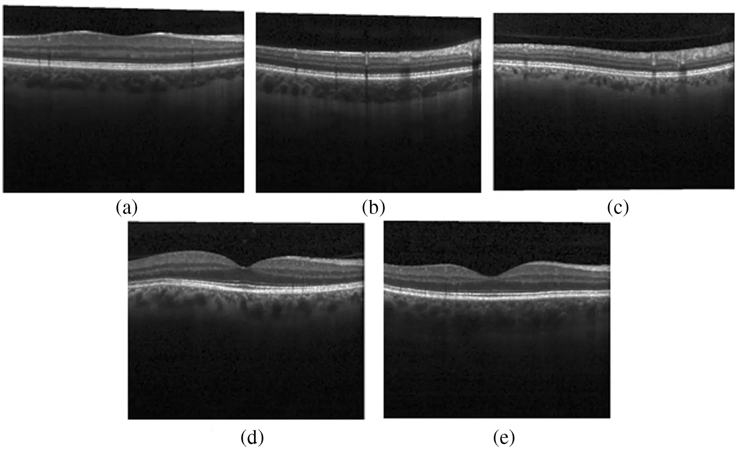 An Ophthalmic Evaluation of Central Serous Chorioretinopathy