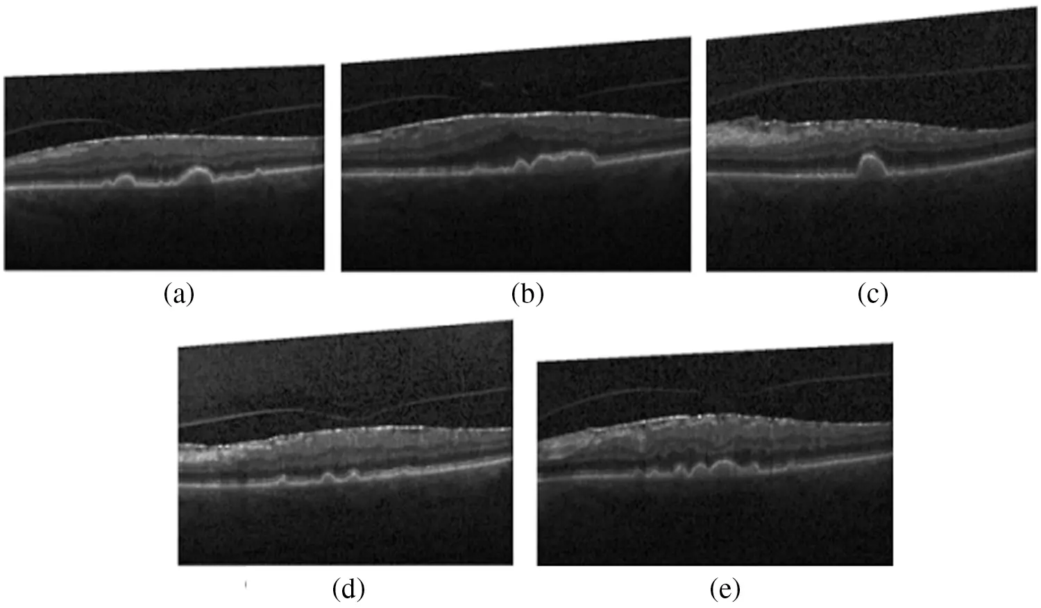 An Ophthalmic Evaluation of Central Serous Chorioretinopathy