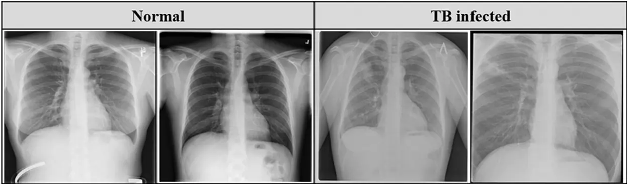 Histogram Matched Chest X-Rays Based Tuberculosis Detection Using CNN