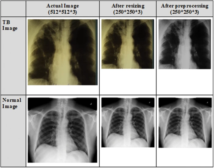 Deep Learning Classification Of Active Tuberculosis Lung 57 Off